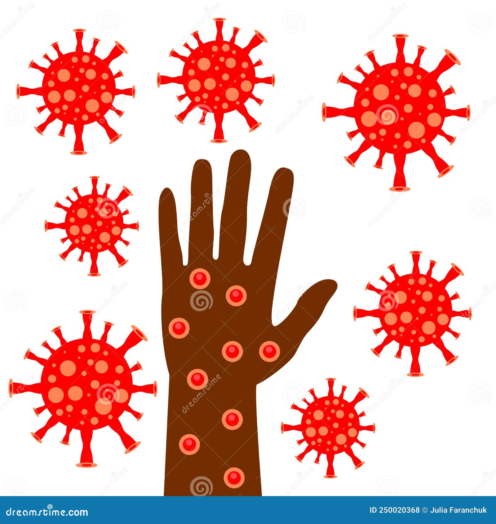 Monkeypox Virus, Hand in Smallpox Ulcers. Smallpox Stock Illustration ...