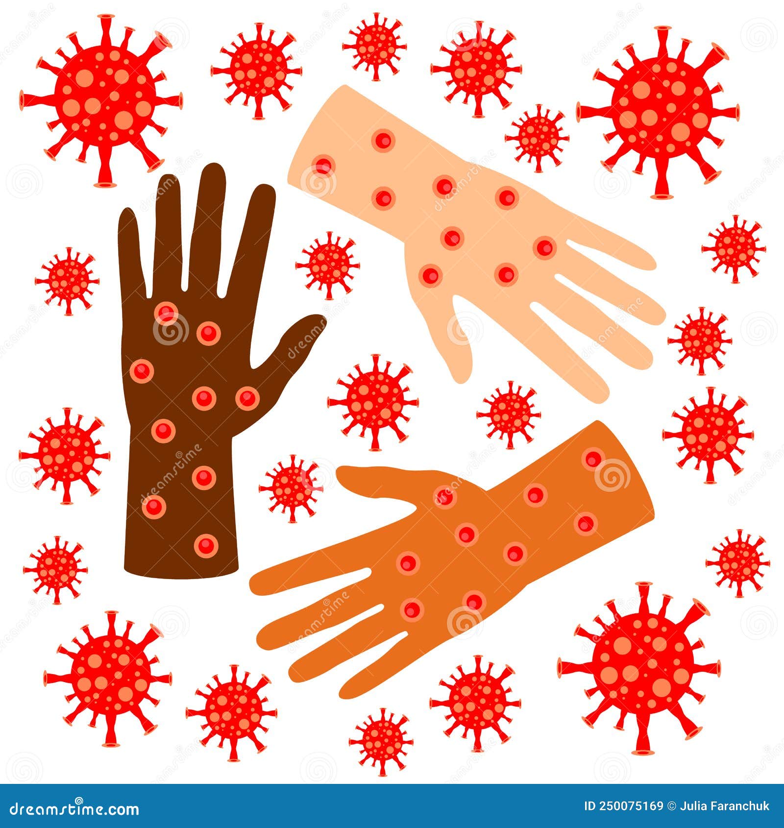 Monkeypox Virus, Hand in Smallpox Ulcers. Smallpox Stock Illustration ...