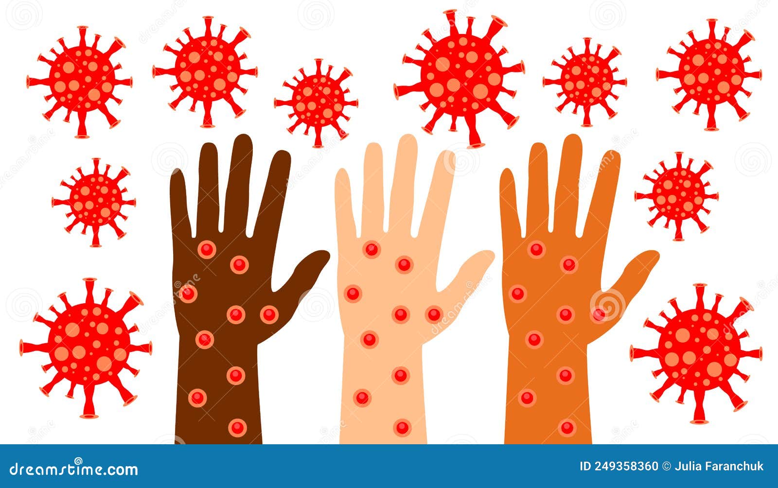 Monkeypox Virus, Hand in Smallpox Ulcers. Smallpox Stock Vector ...