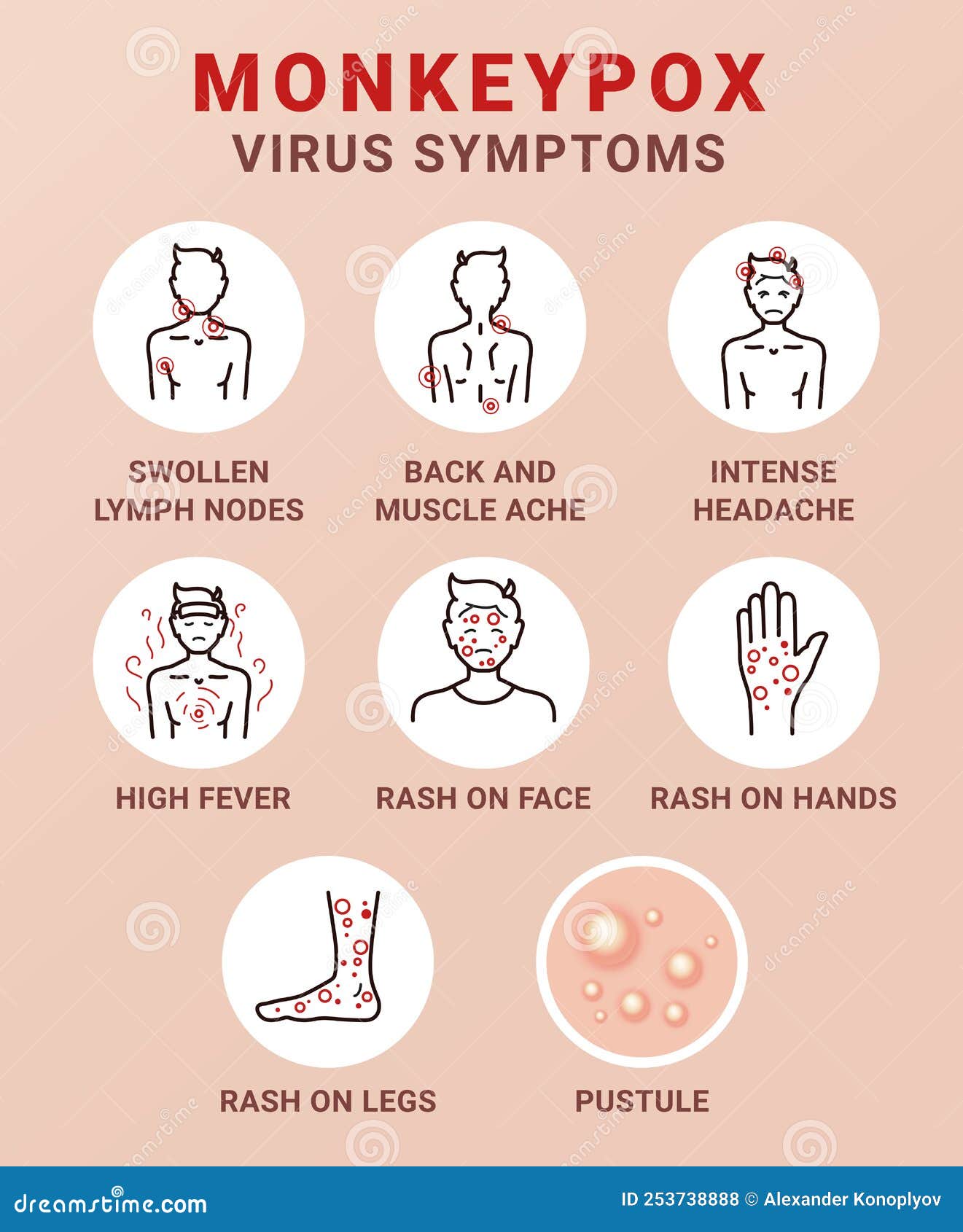 Monkeypox Virus Symptoms Educational Scheme Infographic Poster Vector ...