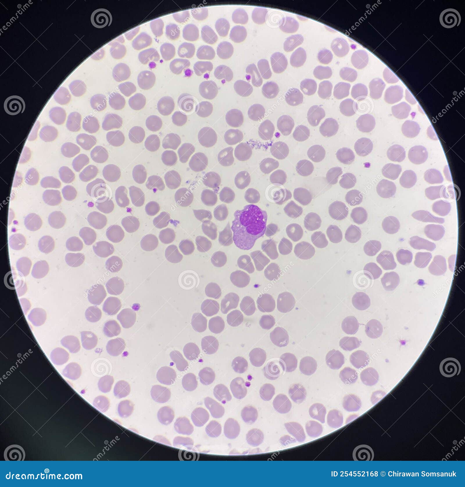 Monocyte White Blood Cells on Center Stock Photo - Image of body ...