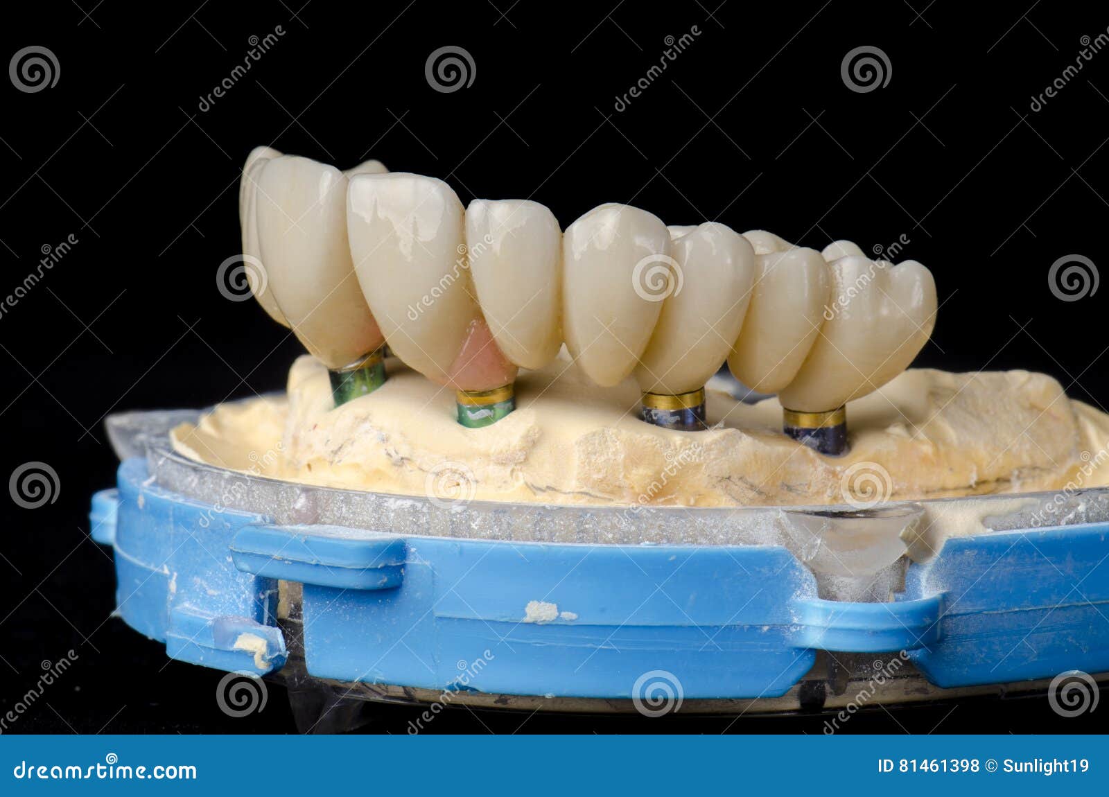 Monolithic zirconia stock photo. Image of false, dentistry - 81461398