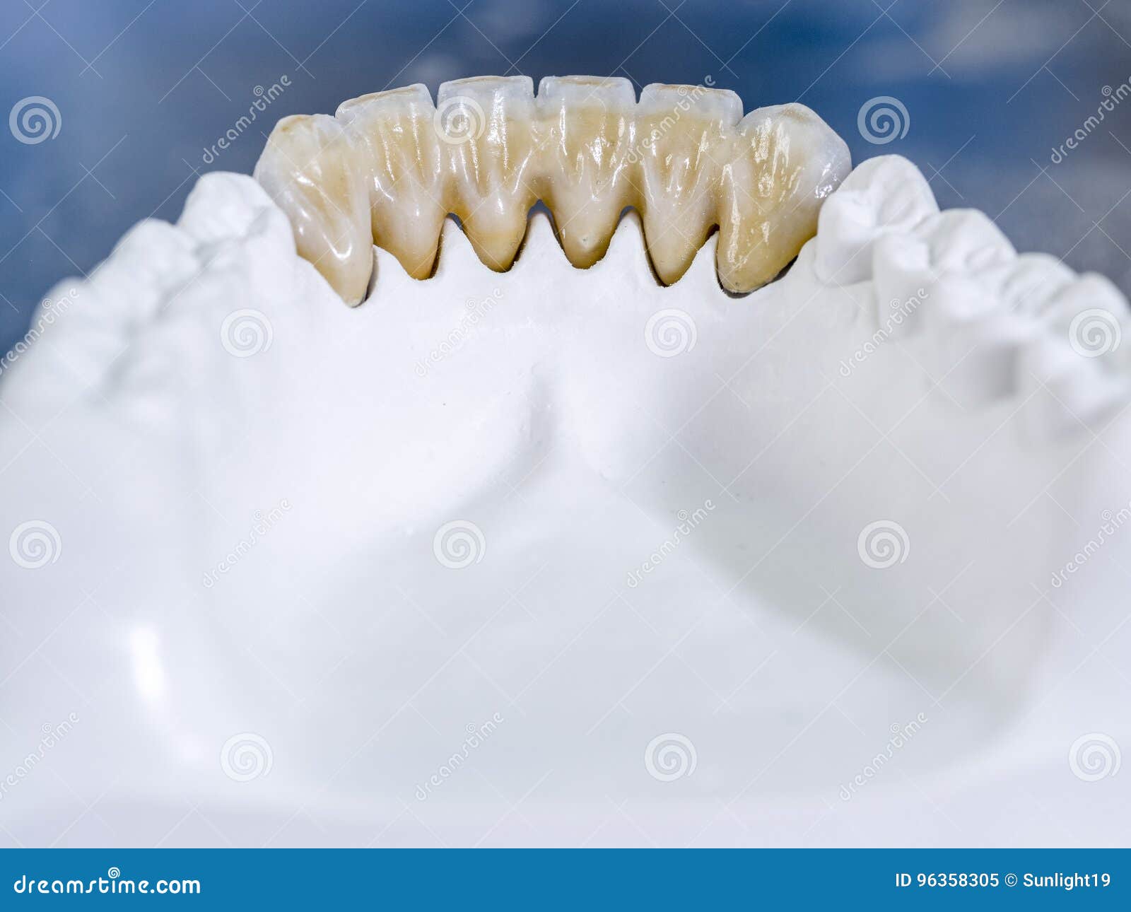 Monolithic Zirconia Restorations. Teeth in a White Cast. Stock Image ...