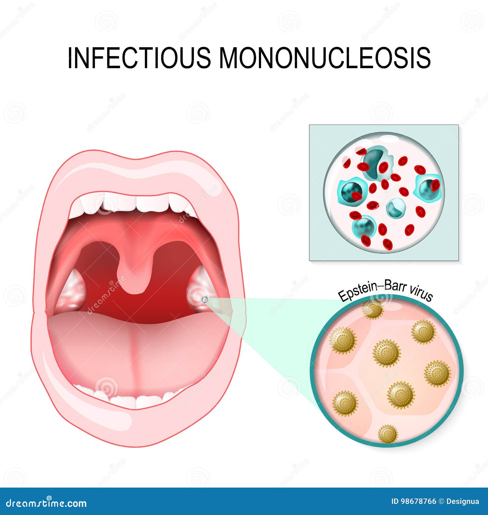 Mononucléose infectieuse illustration de vecteur. Illustration du ...