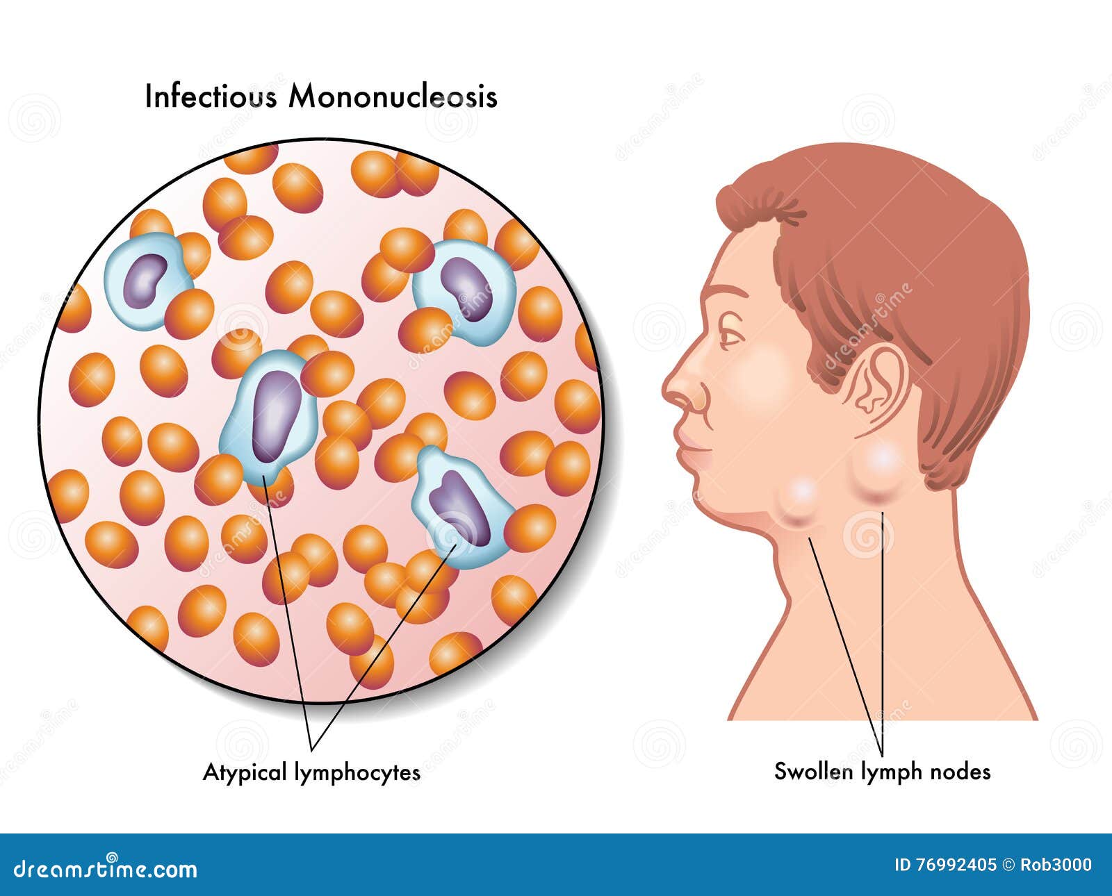 Mononucleosis ilustración del vector. Ilustración de grande - 76992405