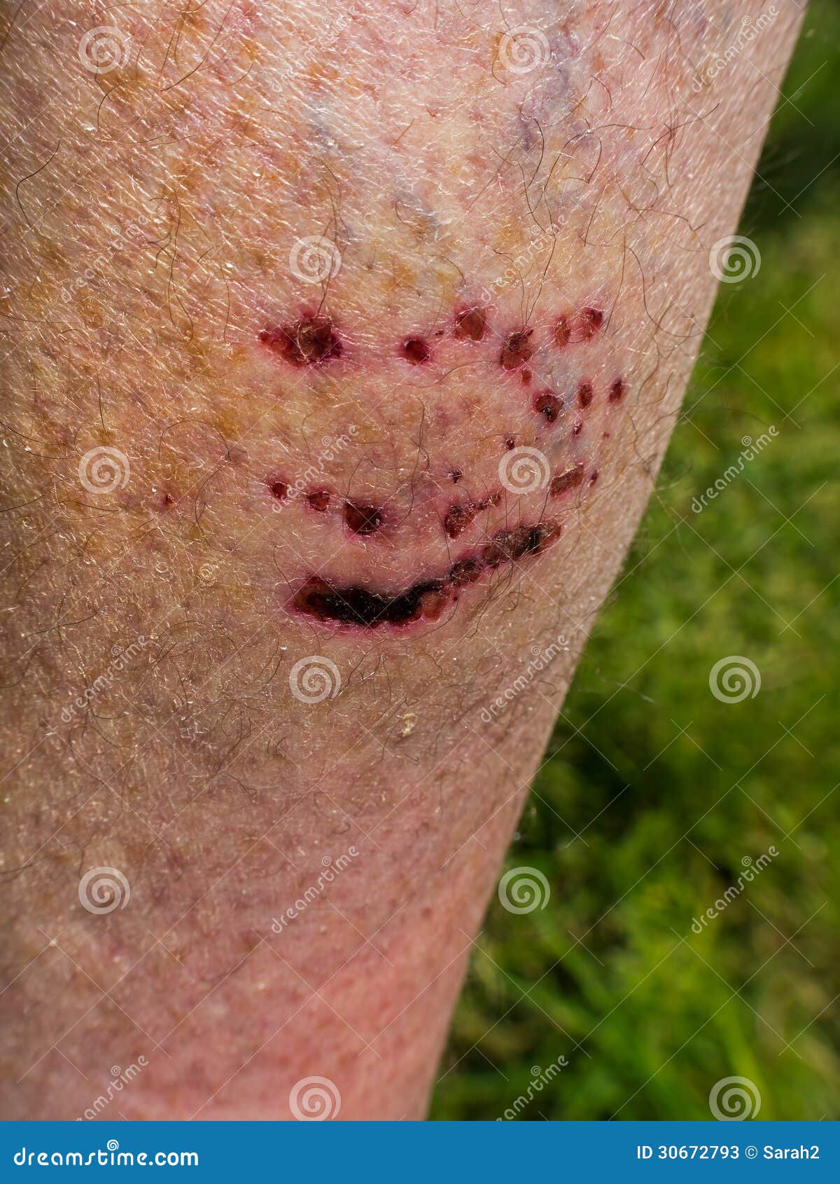 Morso Di Cane Sulla Gamba - Ferita Immagine Stock - Immagine di ...