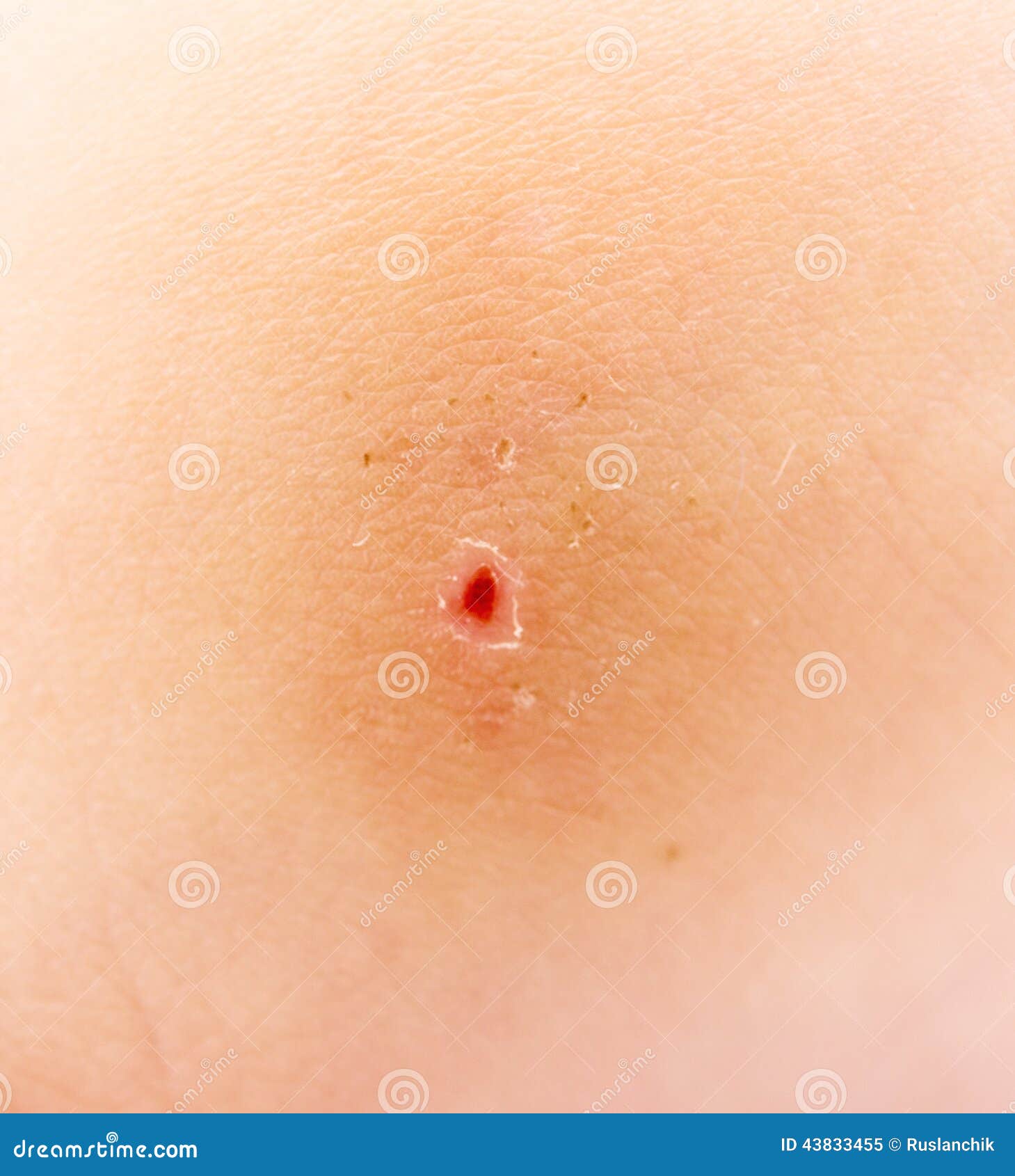 Morso di insetto immagine stock. Immagine di sfondo, veleno - 43833455