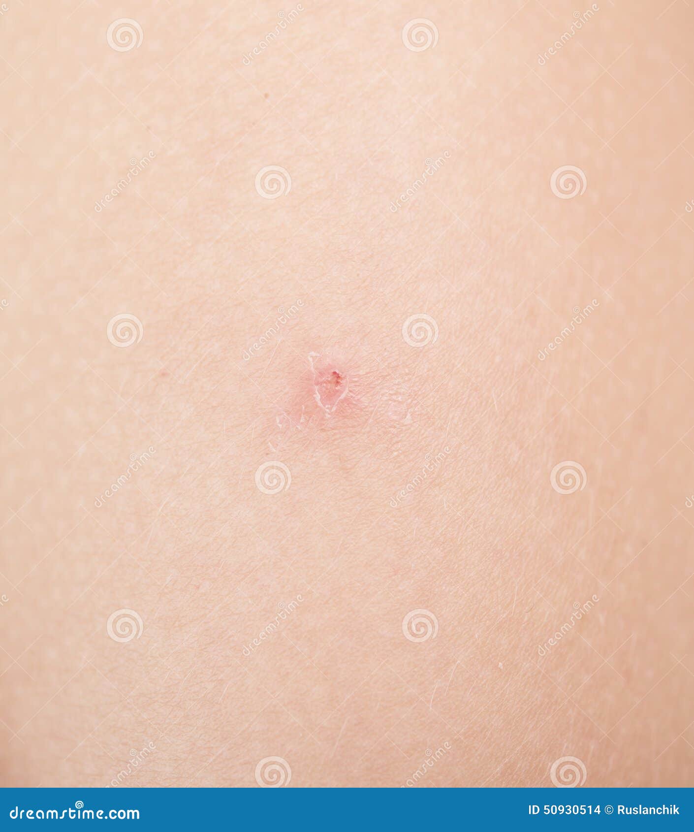 Morso di insetto fotografia stock. Immagine di reazione - 50930514