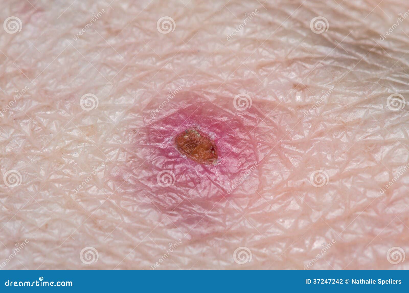 Morso di insetto infettato fotografia stock. Immagine di dermatologia ...