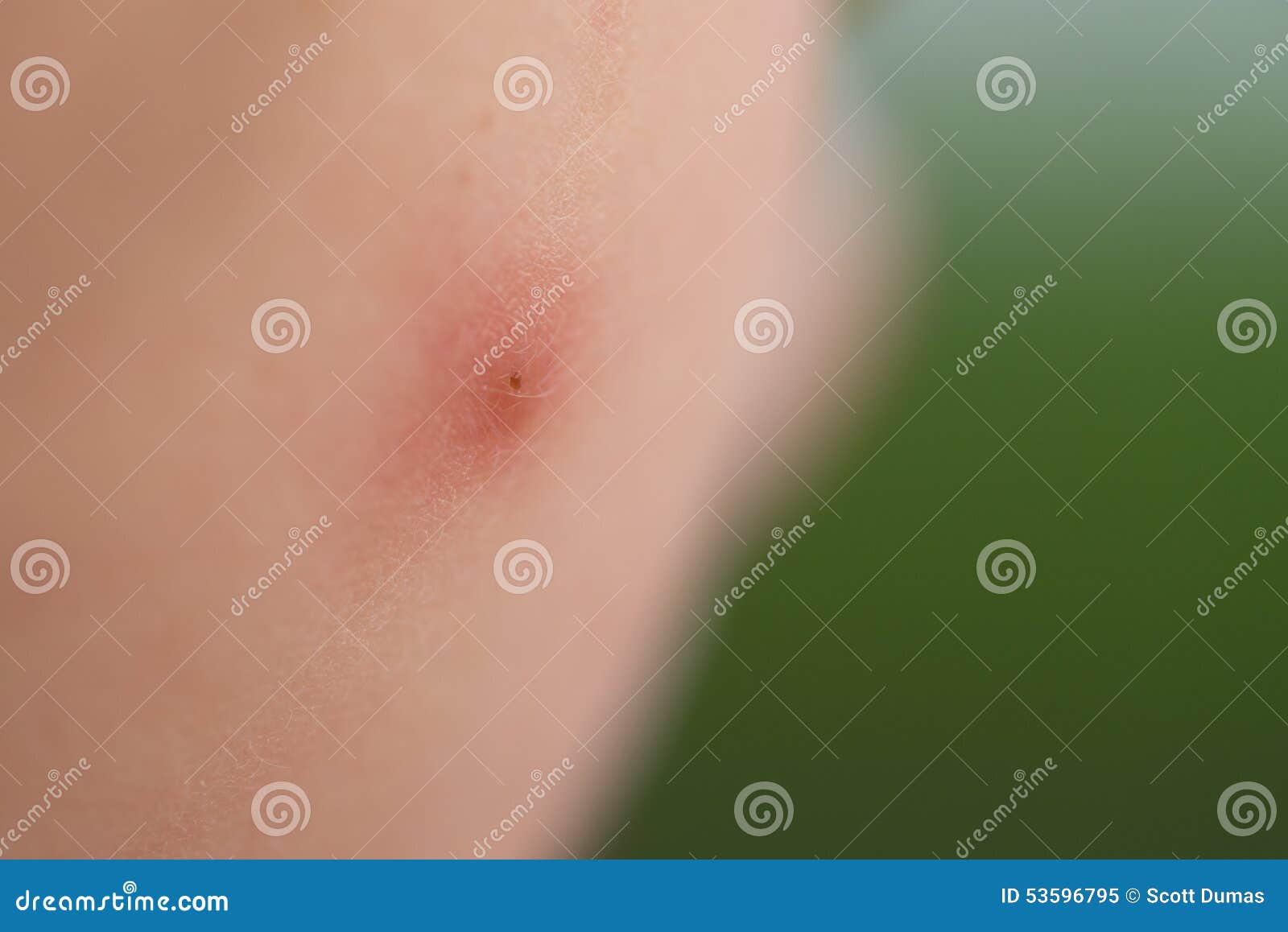 Morsure D'insecte Sur La Joue Image stock - Image du éruption, rouge ...