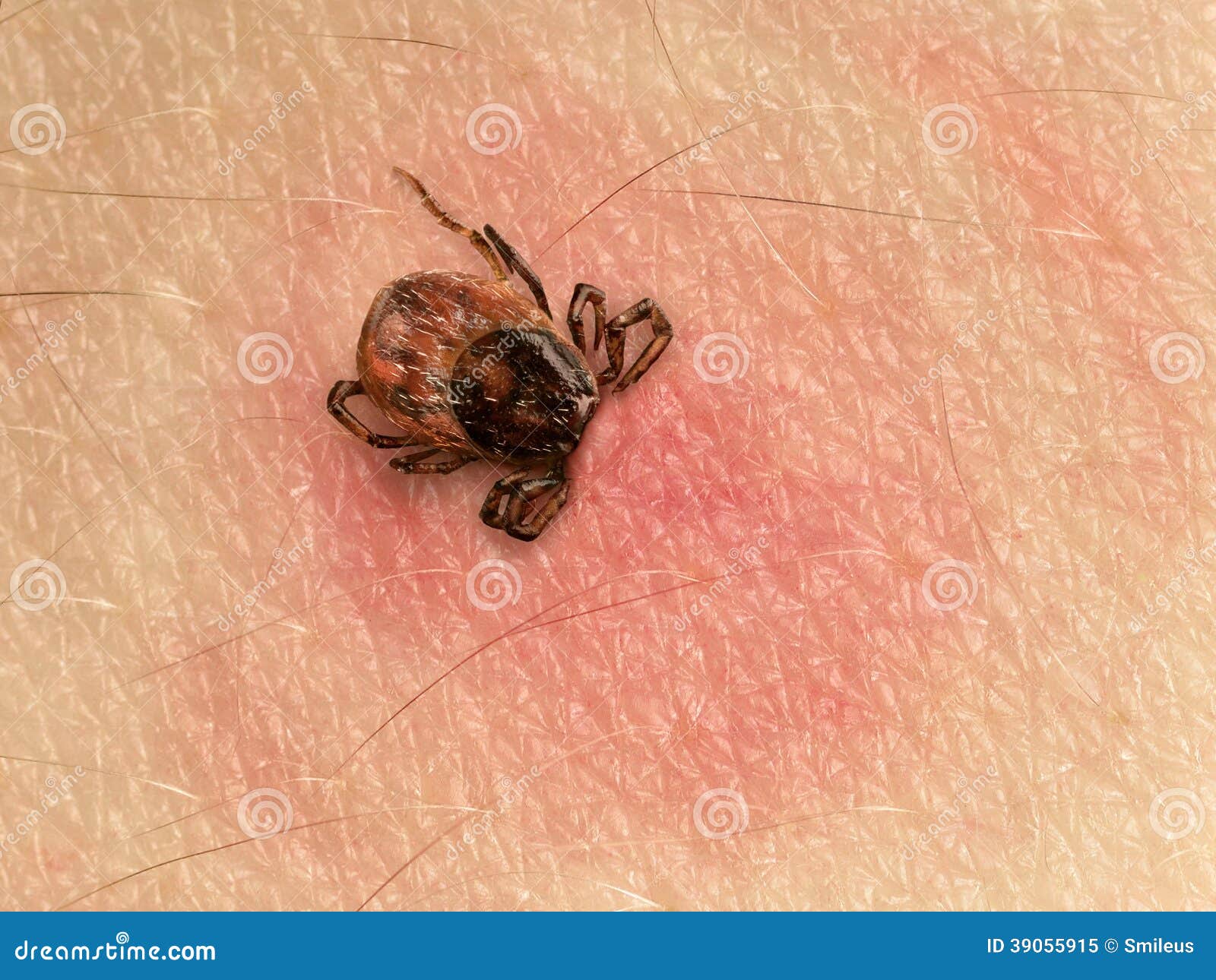Morsure de coutil image stock. Image du lyme, infection - 39055915