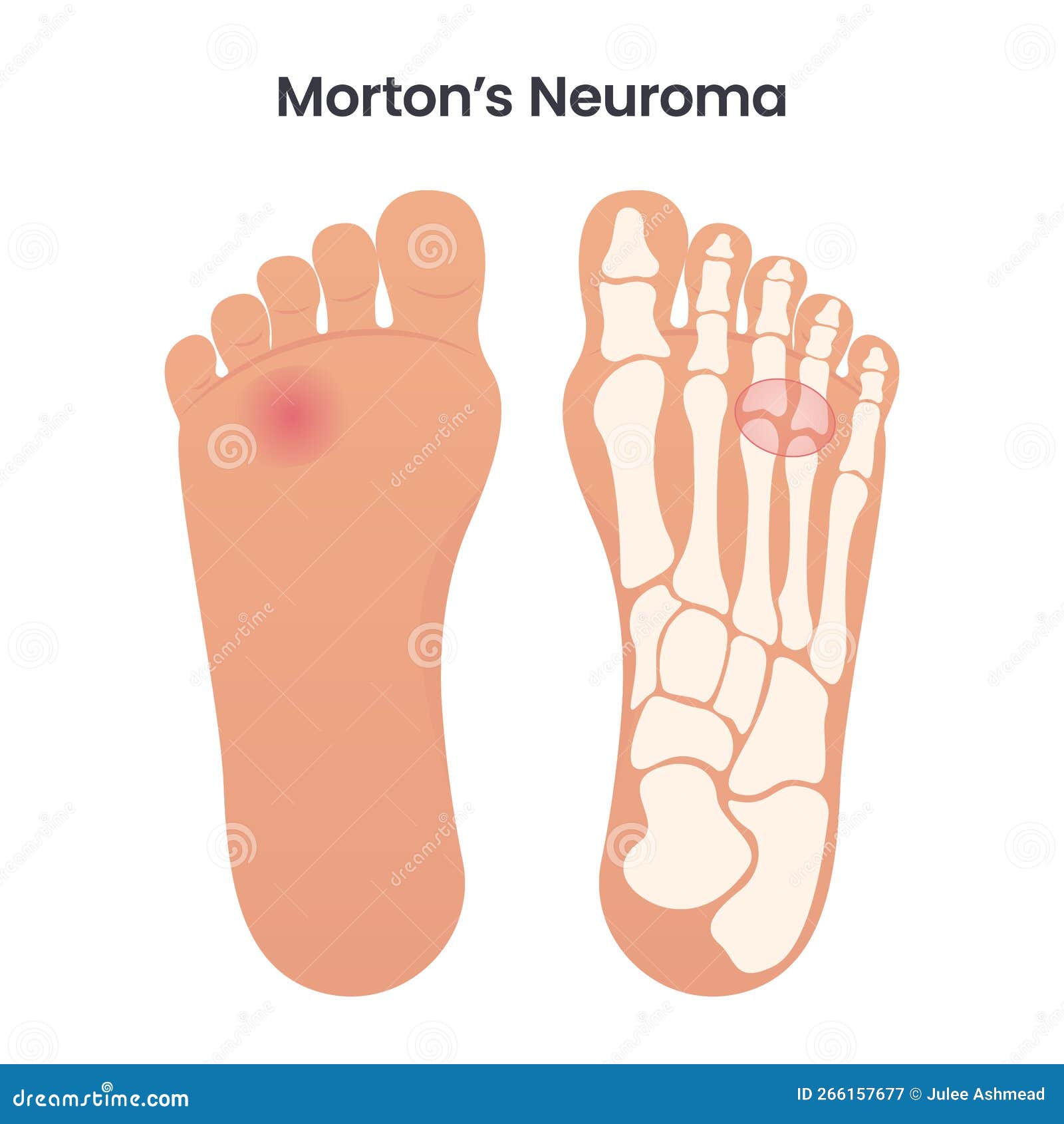 Morton S Neuroma Medical Educational Vector Illustration Graphic Stock ...