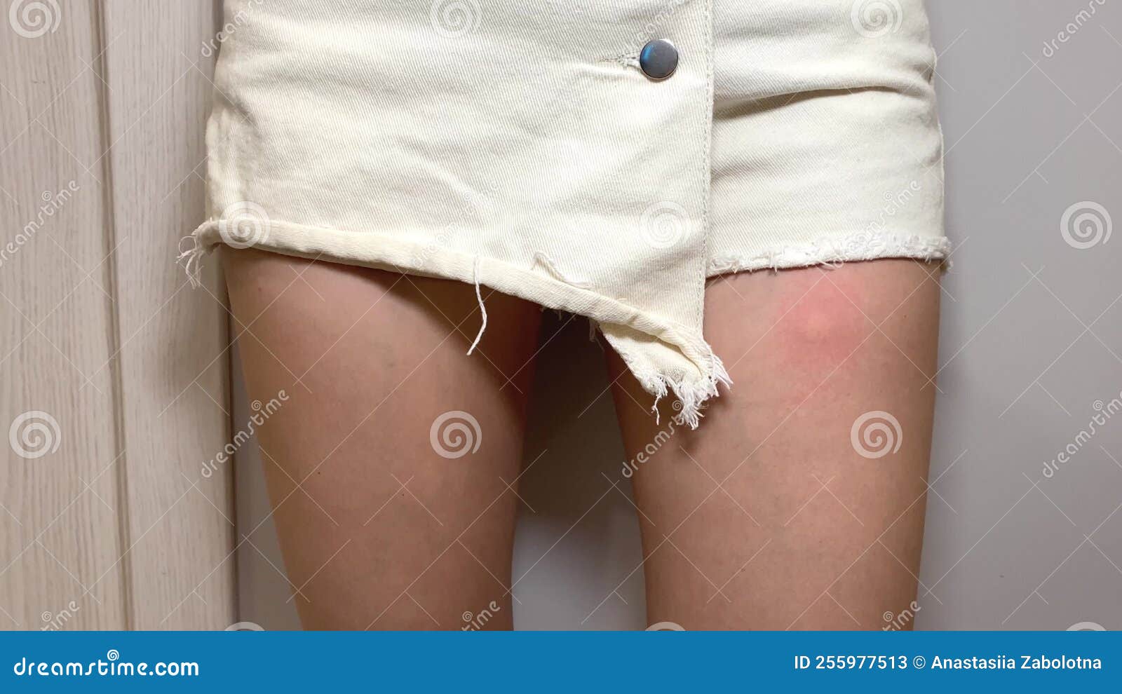 Mosquito Bite On The Leg Of A Young Woman Indoors Allergic Reaction To