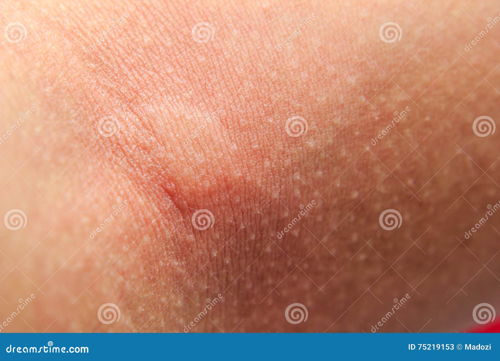Mosquito bites on arm stock image. Image of lonesome - 75219153