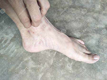 Mosquito bites scars stock photo. Image of bites, care - 116444714