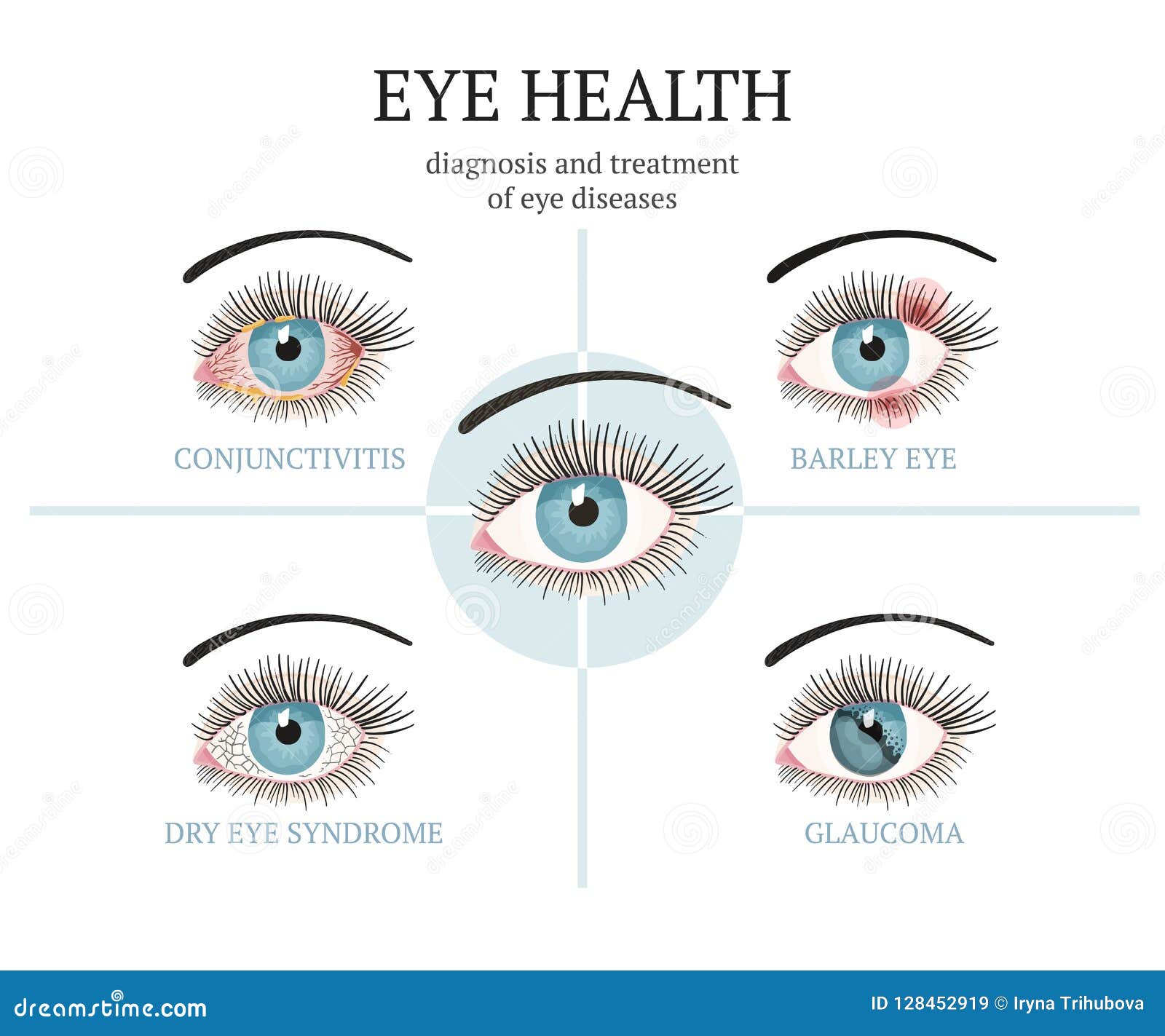 Conjunctivitis Redness And Inflammation Of The Eye Vessels Eye Drops Treatment Infographics