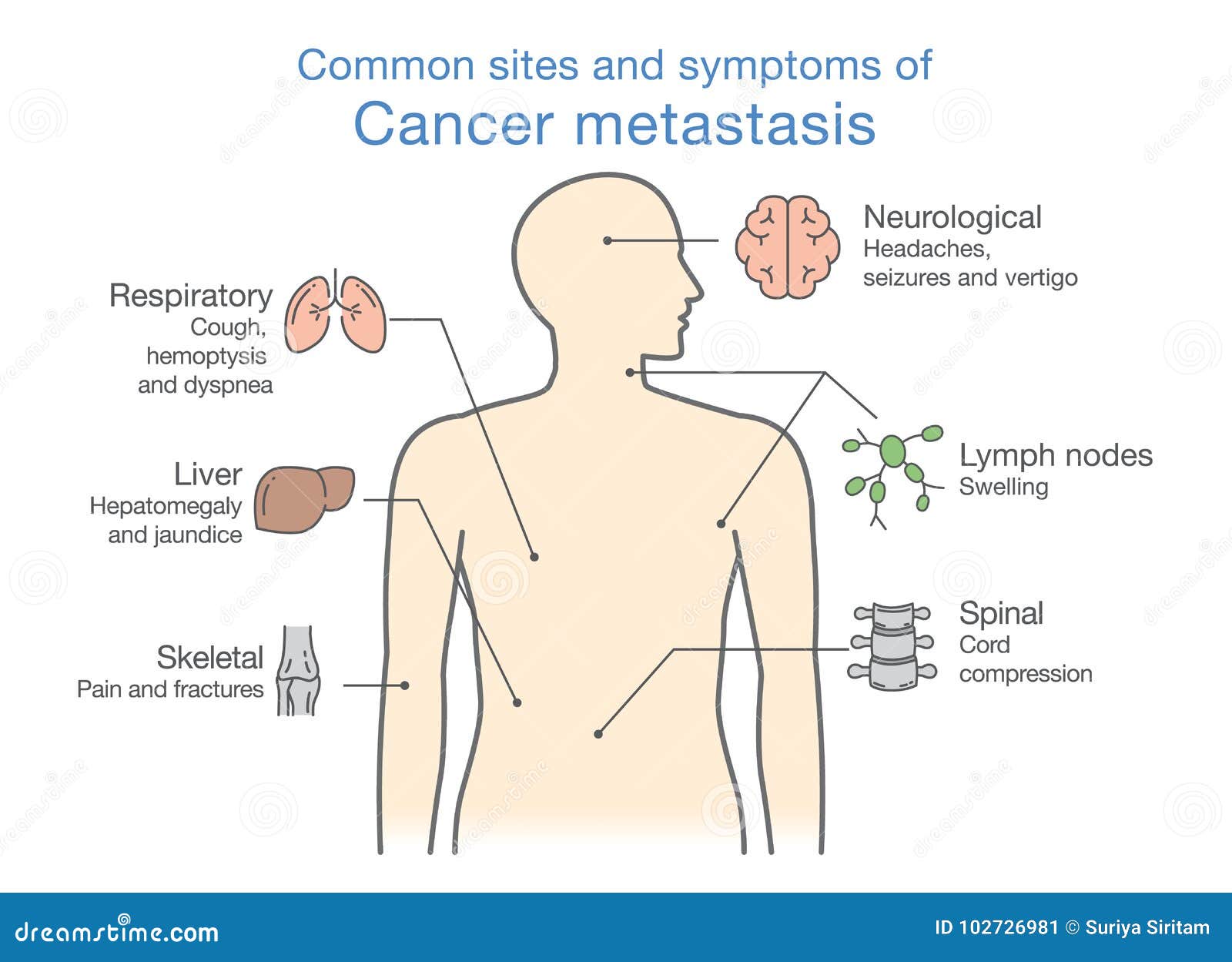 Most Common Sites and Symptoms of Cancer Metastasis. Stock Vector ... Most Common Sites and Symptoms of Cancer Metastasis. Stock Vector ...