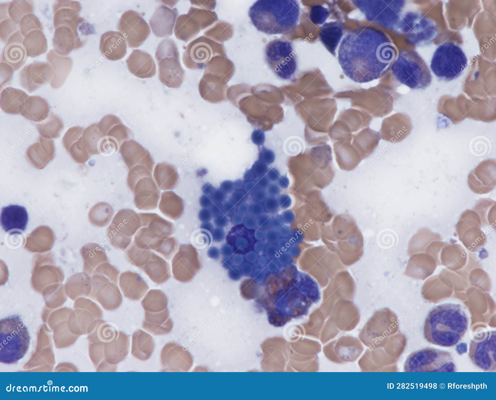 Mott cell in bone marrow. stock photo. Image of multiple - 282519498