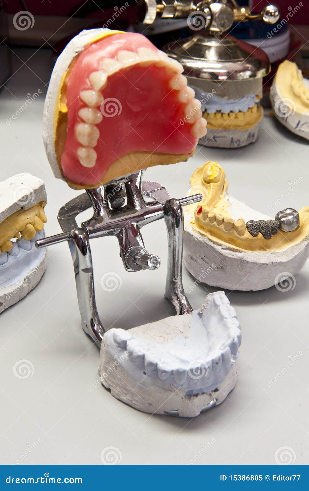 Teeth Model Showing An Implant Crown Bridge Model. Stock Photo ...