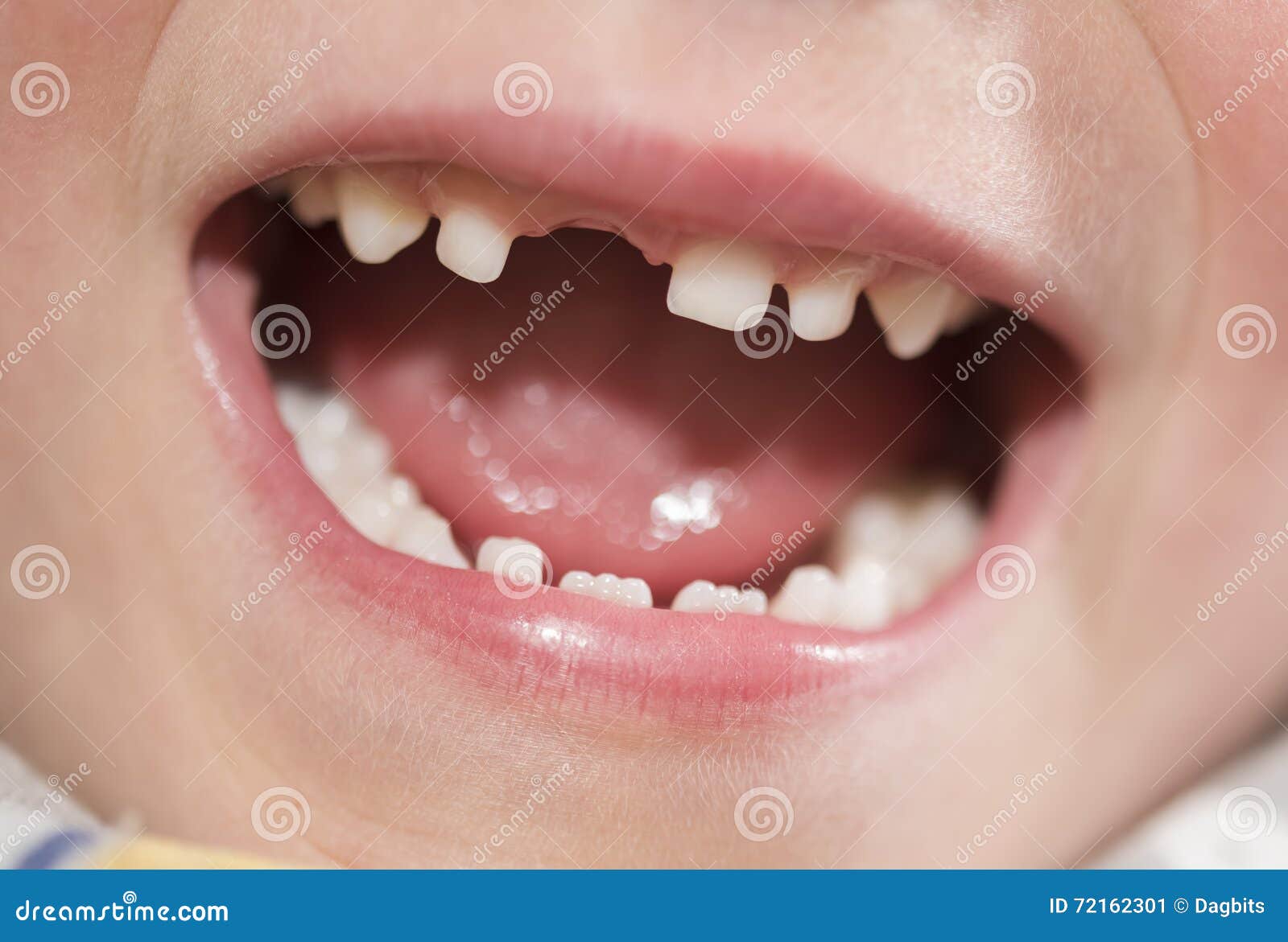 Mouth of a Boy with Missing Tooth. Stock Image - Image of lips, close ...