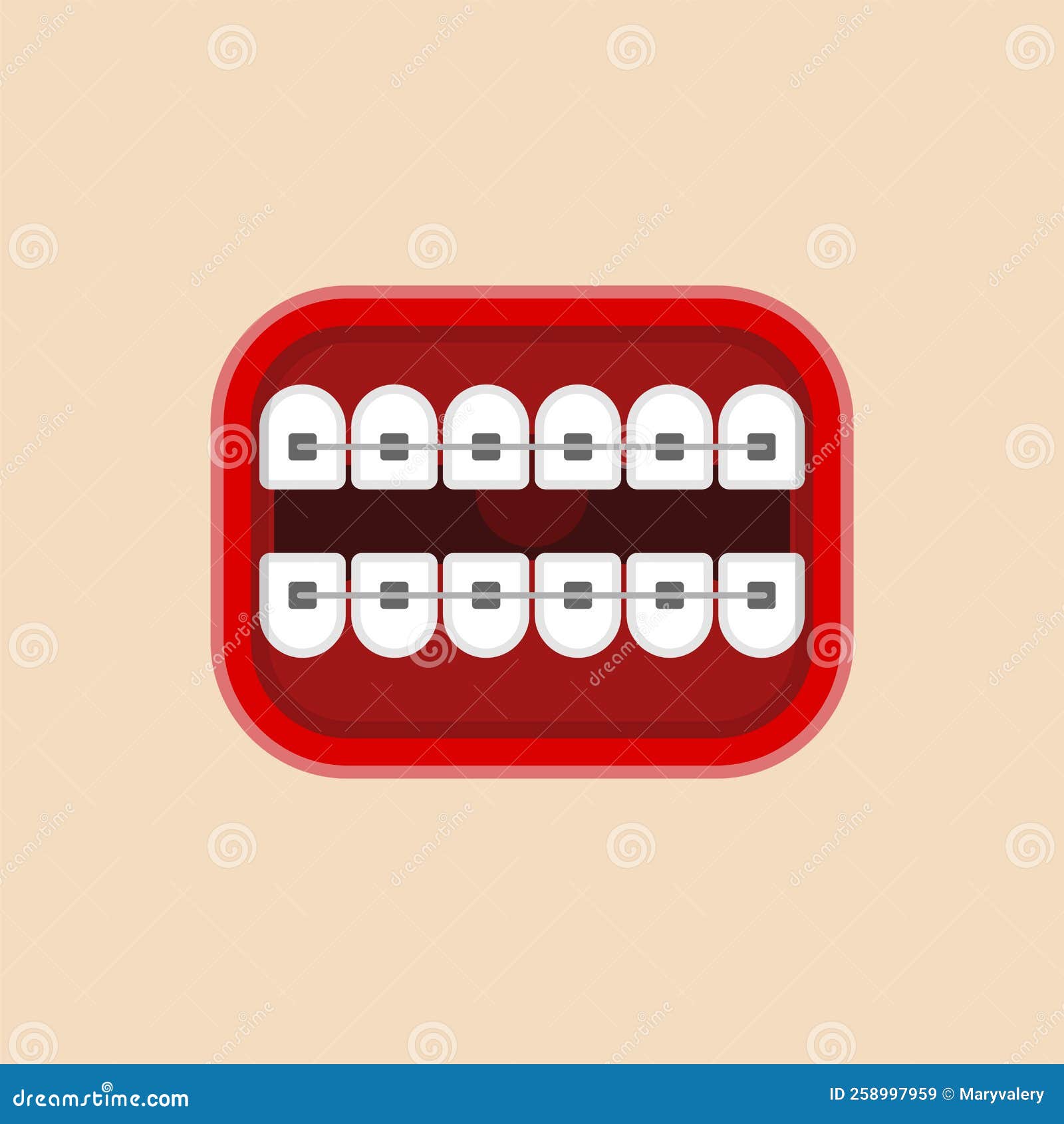 Mouth with Braces Isolated. Correction of Occlusion and Crooked Teeth ...