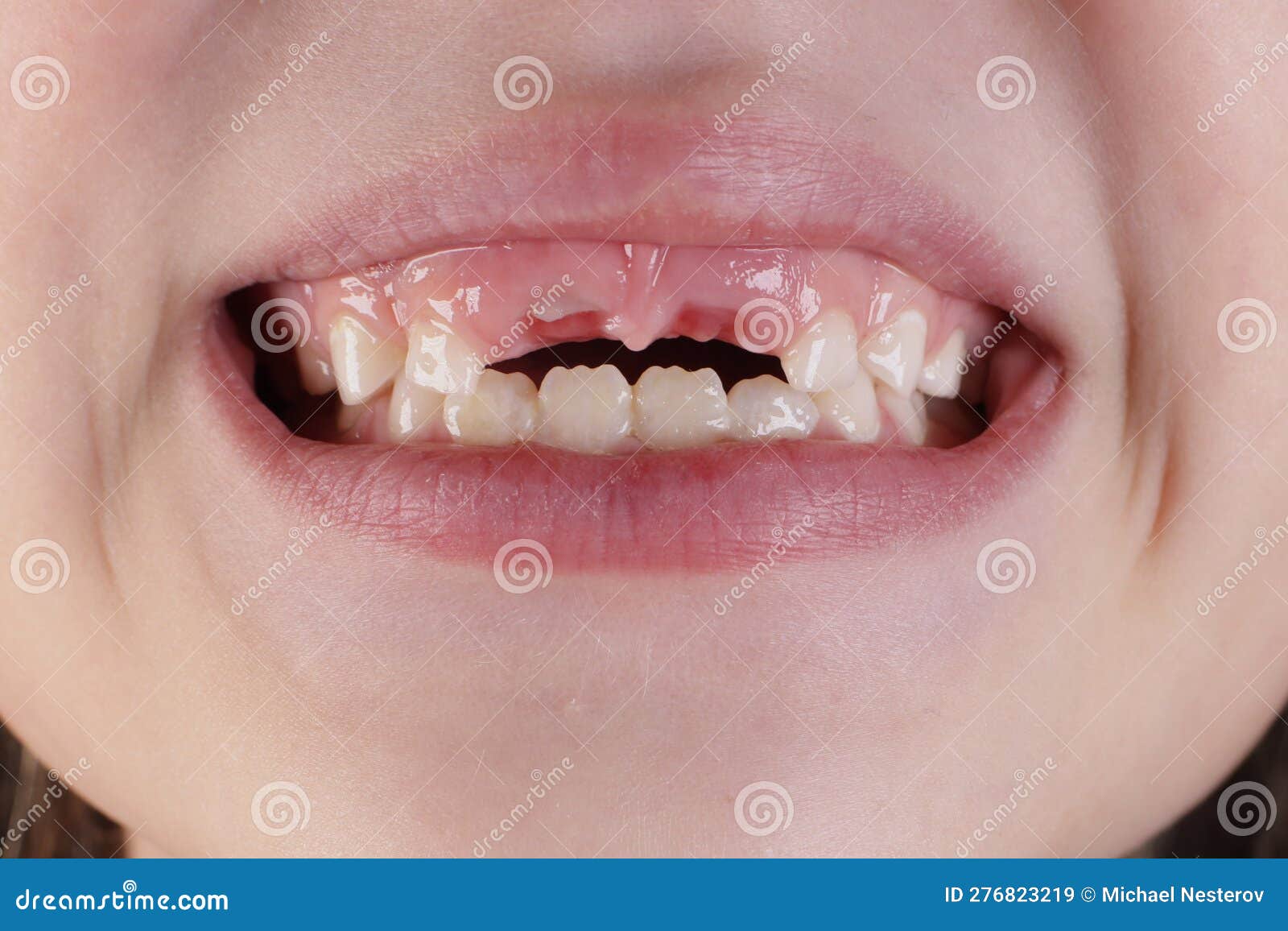 Mouth without Front Milk Teeth Close-up Stock Image - Image of growth ...