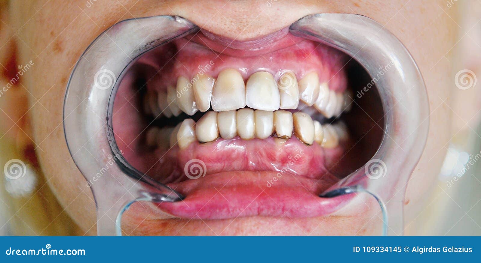 Mouth with Prosthetic Teeth Stock Image - Image of medicine, blood ...