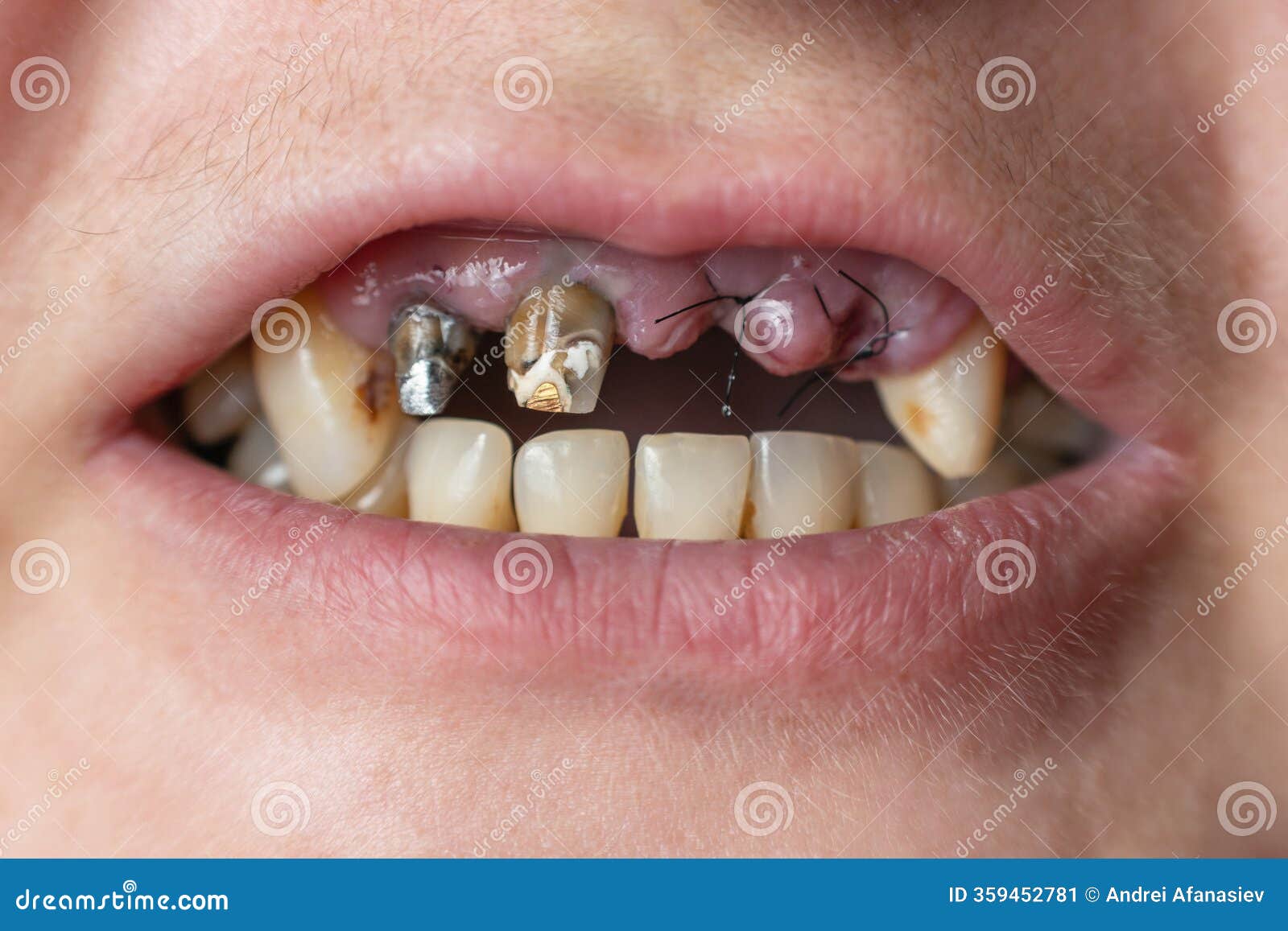 Mouth with Removed Front Teeth and Sutures on the Gums for Subsequent ...