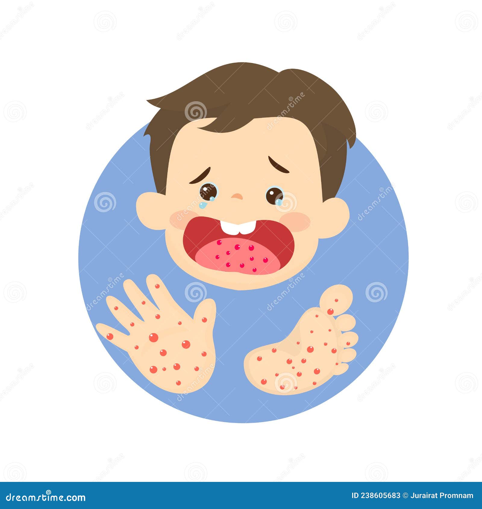 Hand Foot and Mouth Disease Vector. Stock Illustration - Illustration ...