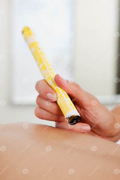 Moxibustion Acupuncture Technique Stock Image - Image of back, moxa ...