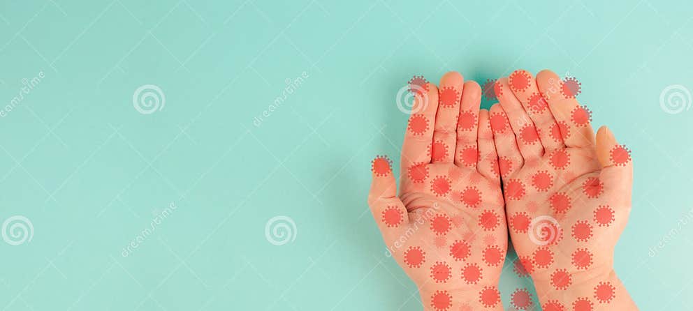 Mpox, Hands with Monkeypox Rash, Outbreak of the MPXV Virus, Infectious ...