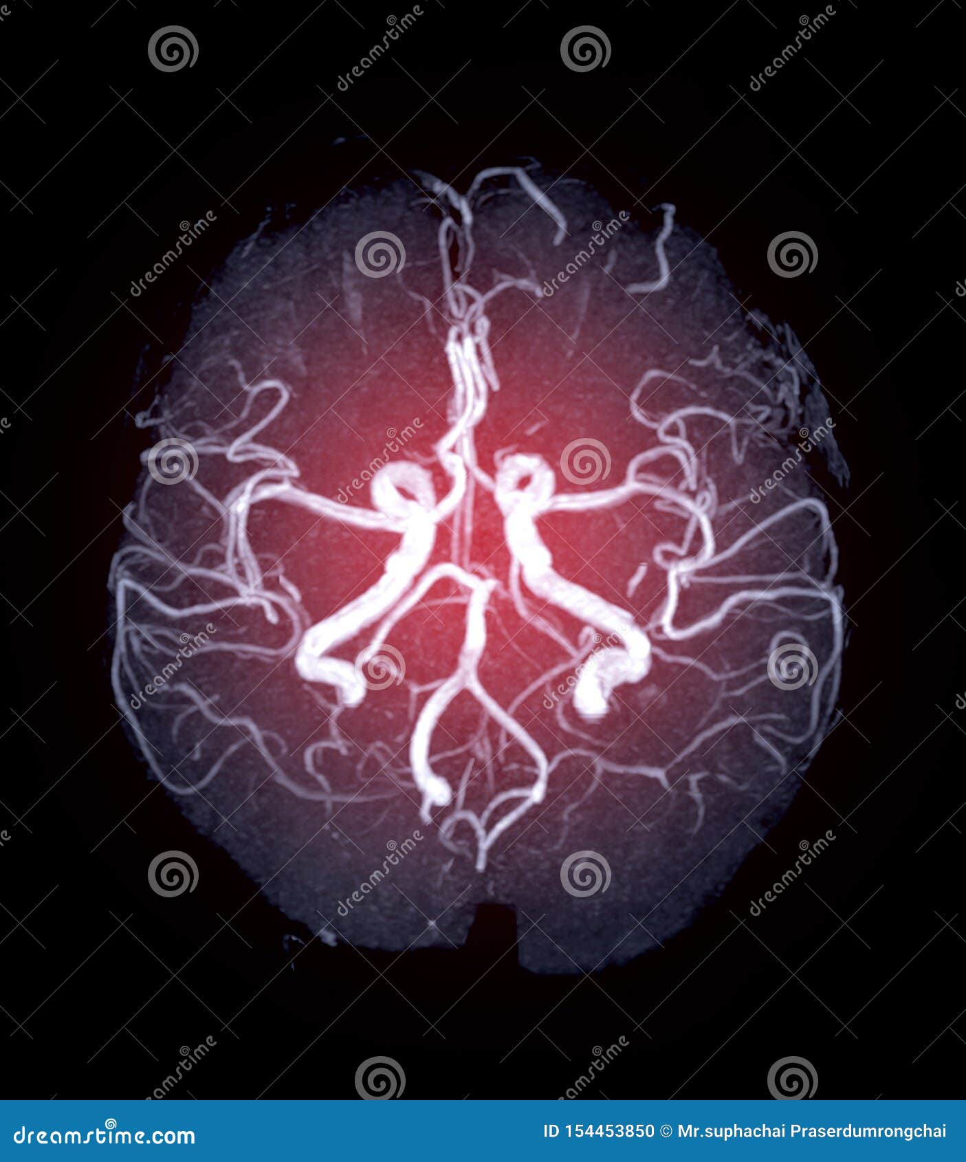 MRA Brain or Magnetic Resonance Angiography of the Brain. Stock Photo ... MRA Brain or Magnetic Resonance Angiography of the Brain. Stock Photo ...
