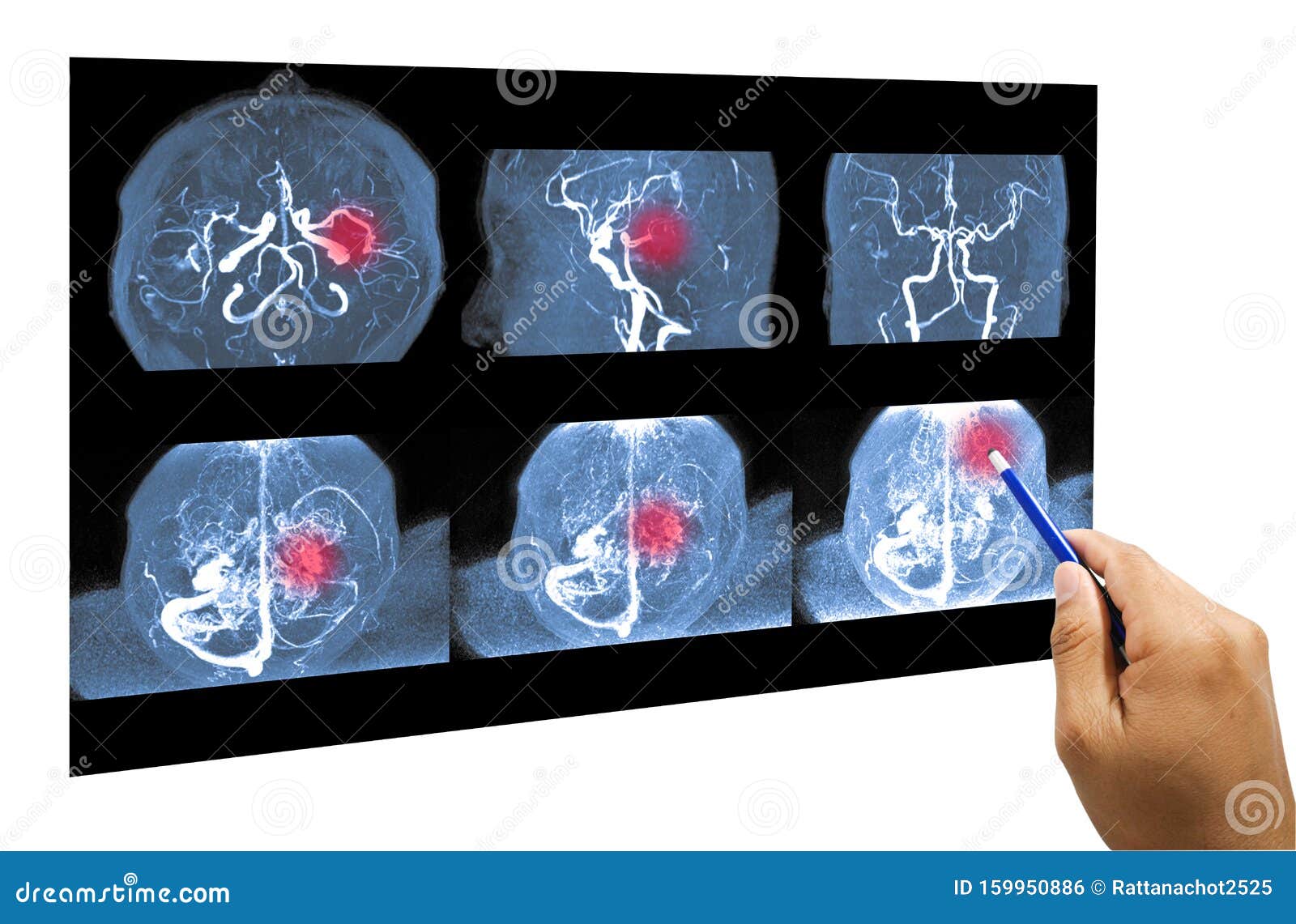MRA Brain or Magnetic Resonance Angiography of Cerebral Artery in the ... MRA Brain or Magnetic Resonance Angiography of Cerebral Artery in the ...