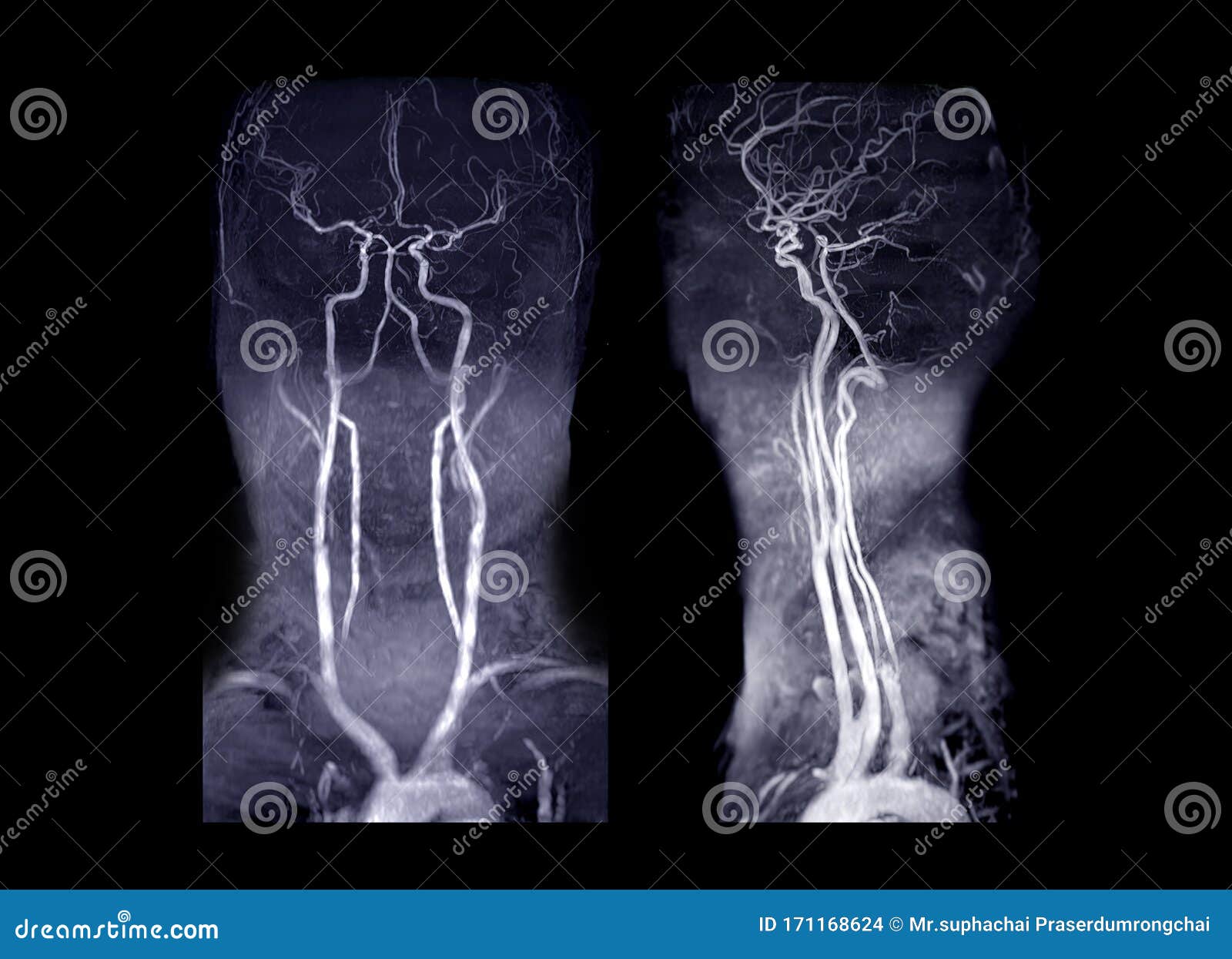 MRA Brain and Neck or Magnetic Resonance Angiography MRA of Cerebral ... MRA Brain and Neck or Magnetic Resonance Angiography MRA of Cerebral ...