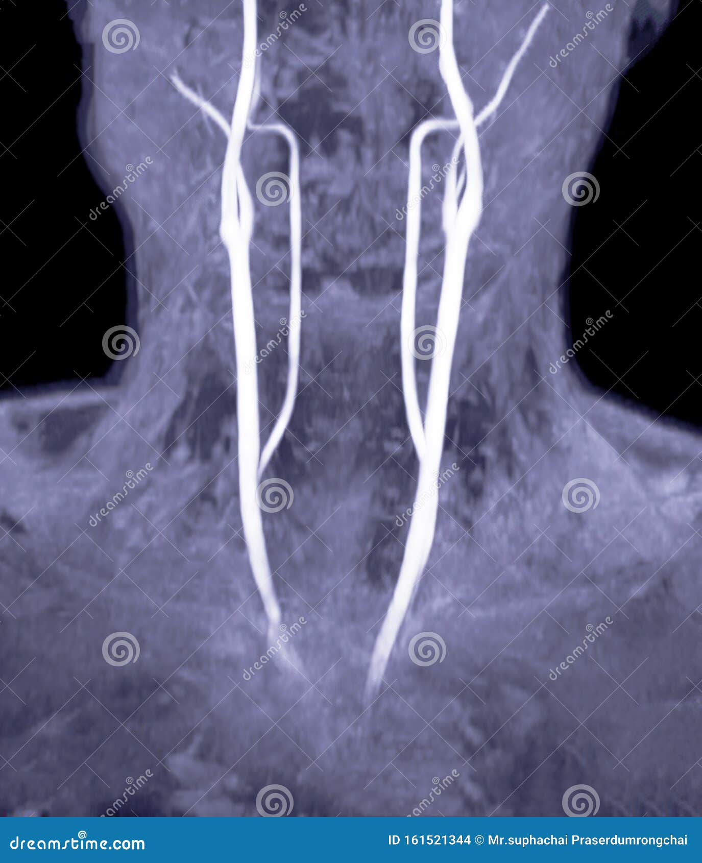 MRA Carotid Artery of Common Carotid Artery in the Neck. Stock Photo ... MRA Carotid Artery of Common Carotid Artery in the Neck. Stock Photo ...
