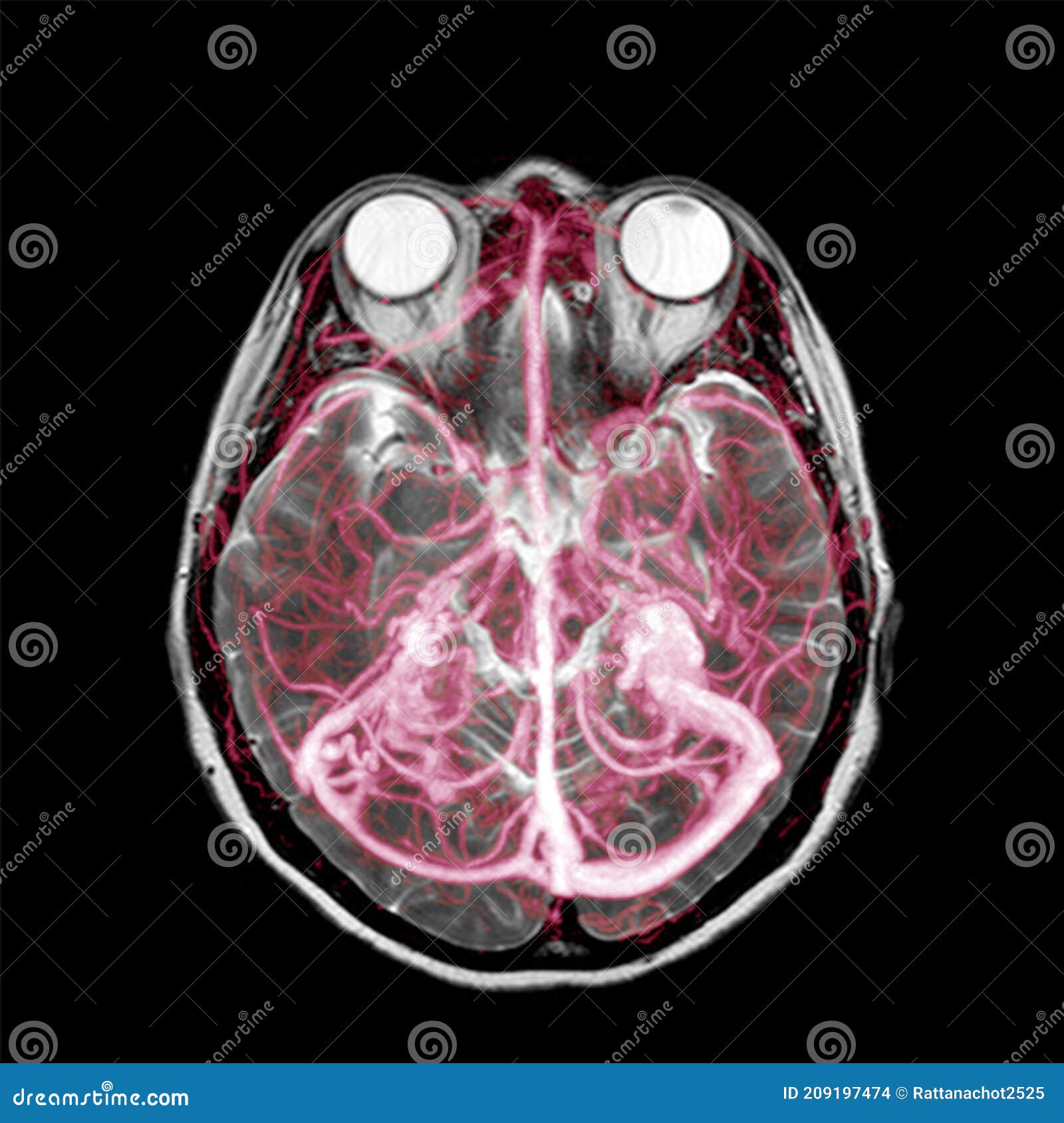MRA (magnetic Resonance Angiography) of Brain for Stroke Patient ... MRA (magnetic Resonance Angiography) of Brain for Stroke Patient ...