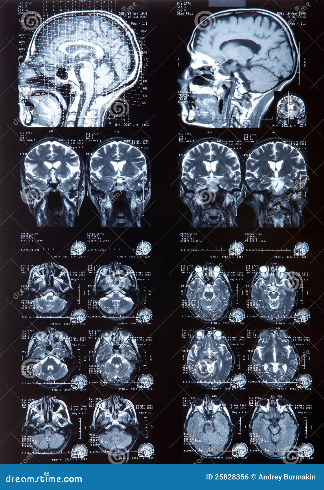 Mri Scan Result