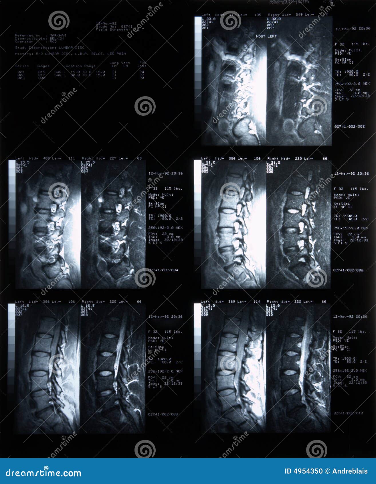 MRI of back stock photo. Image of science, bones, radioactive - 4954350