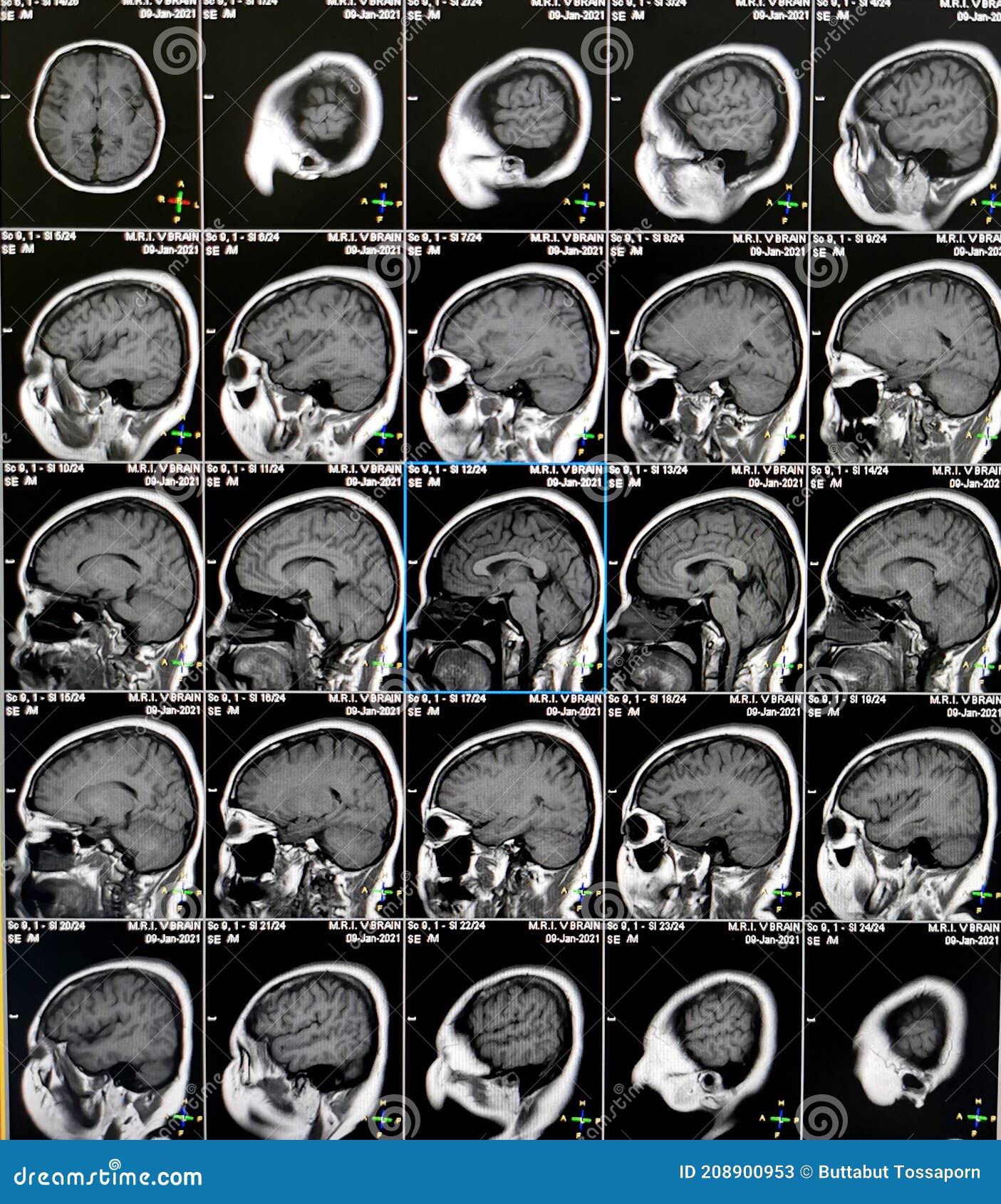 Mri Beelden Mri Brain Sagital Plan T1wigth Image Protocol. Stock ...