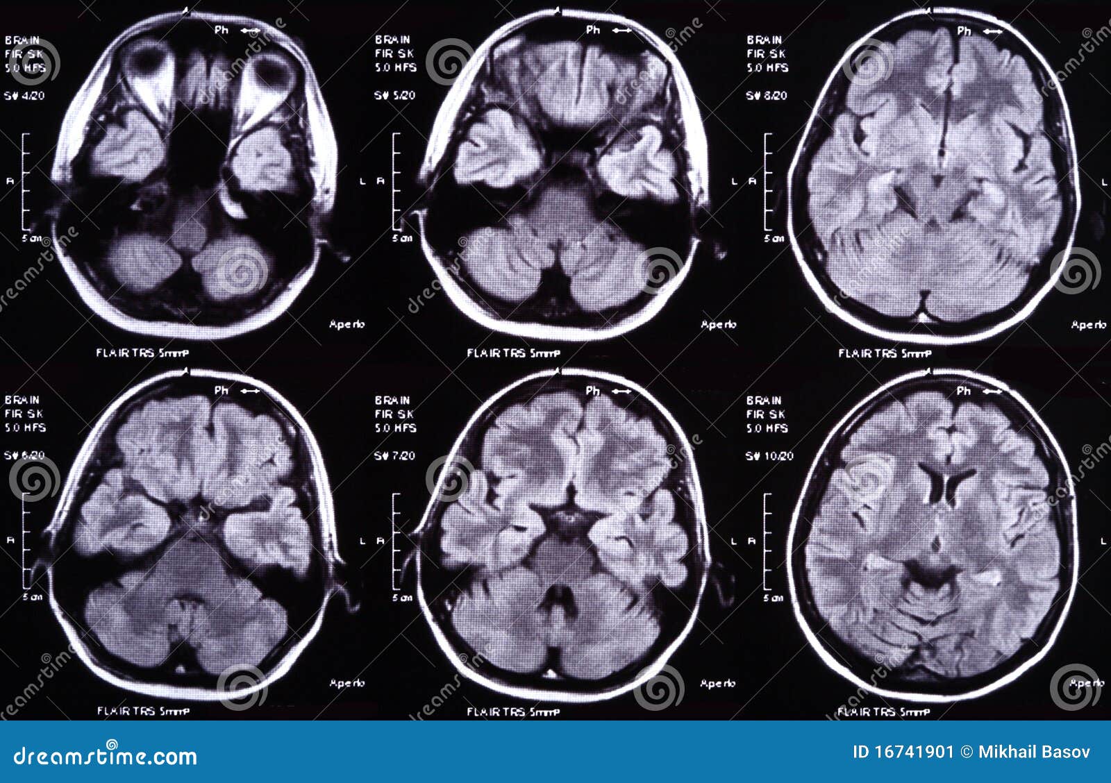 MRI of the brain stock image. Image of medical, resonance - 16741901
