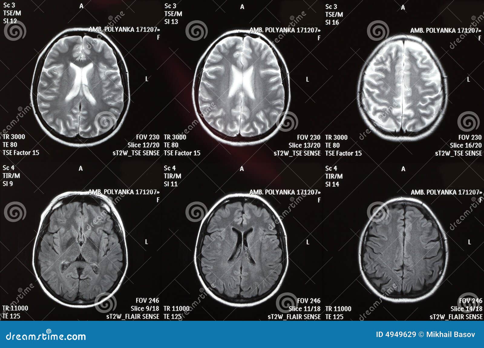 MRI of a brain stock image. Image of services, anatomy - 4949629