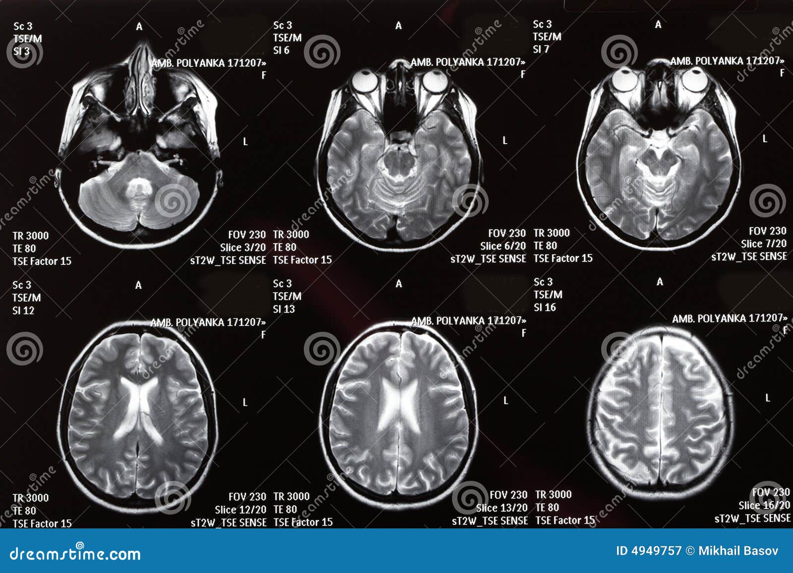 MRI of a brain stock image. Image of anatomy, medical - 4949757