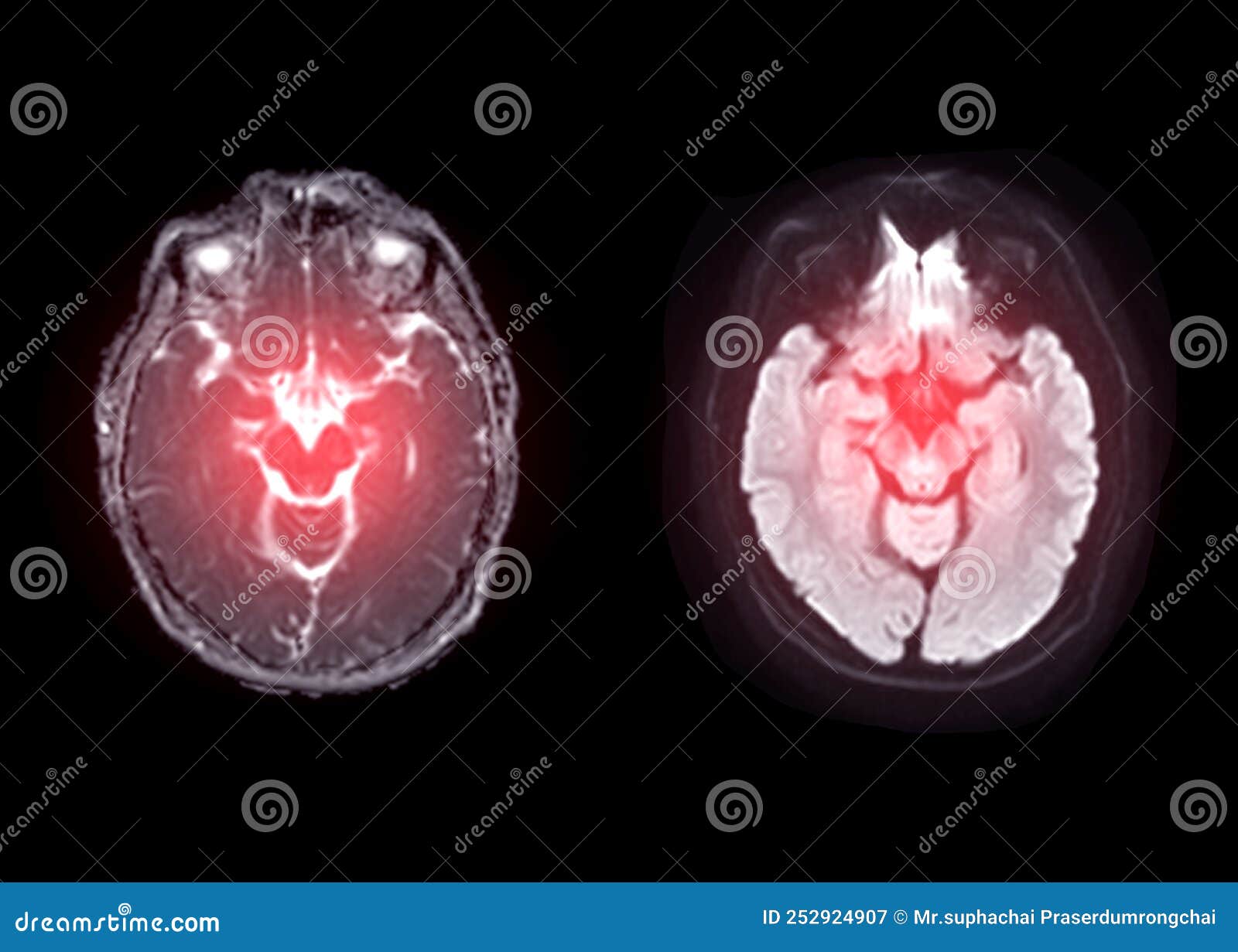 MRA Brain Axial MIP View Showing Cerebral Artery Stock Photography ...