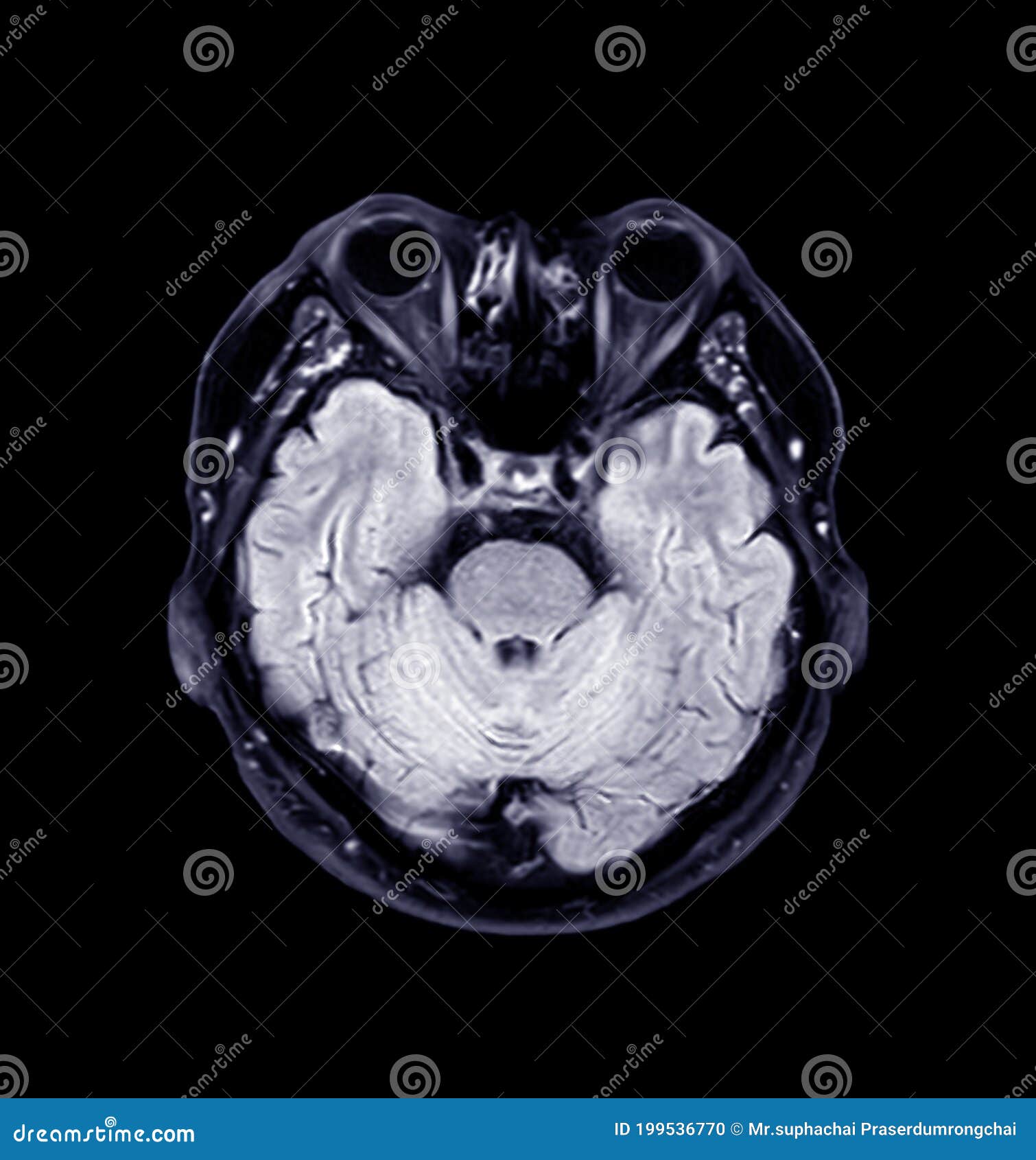 MRI of the Brain Axial T2 Flair Stock Illustration - Illustration of ... MRI of the Brain Axial T2 Flair Stock Illustration - Illustration of ...