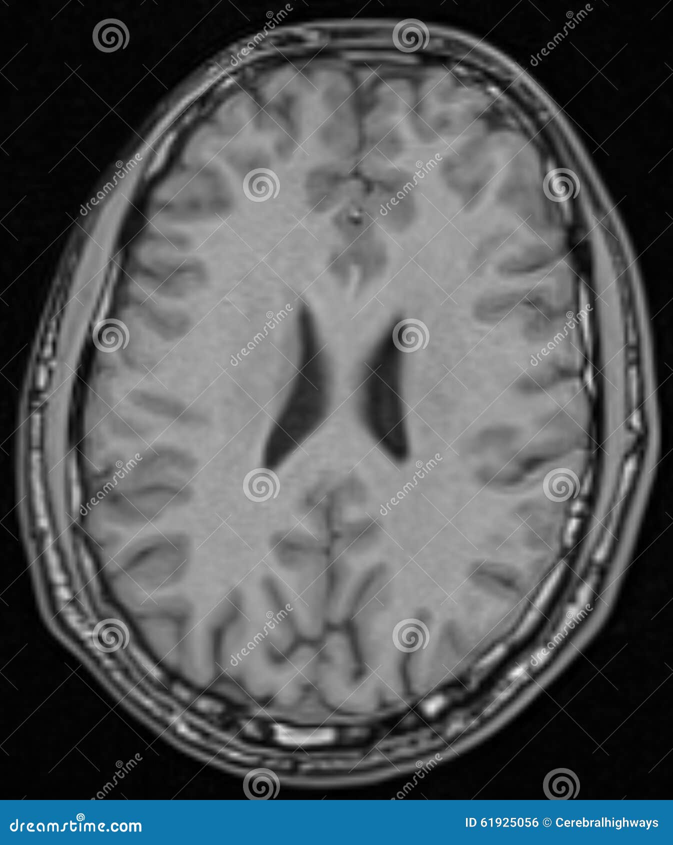 MRI Brain Axial View foto de archivo. Imagen de blanco - 61925056