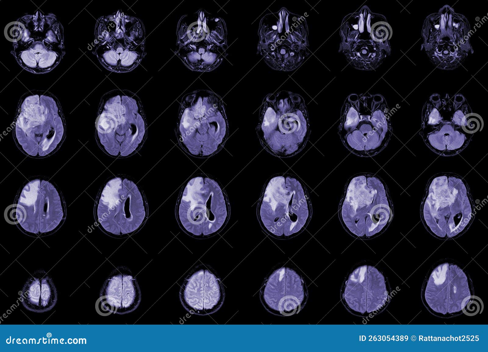 Mri Brain Axial Views To Evaluate Brain Tumor Stock Image Image Of Chemotherapy Brainstem