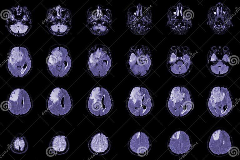 Mri Brain Axial Views To Evaluate Brain Tumor Stock Image Image Of Chemotherapy Brainstem