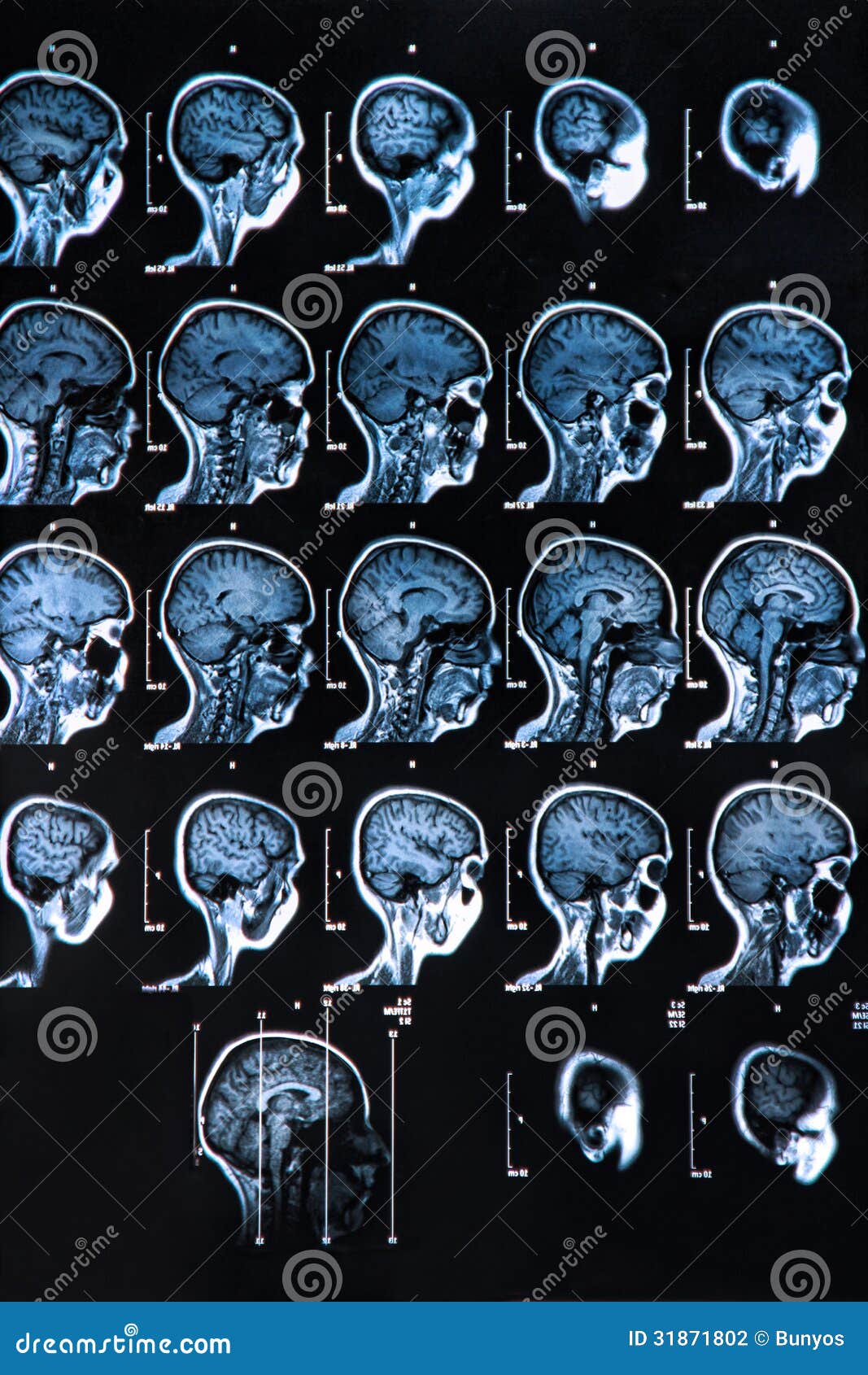 Mri Brain Scan foto de stock. Imagem de anatomia, fase - 31871802