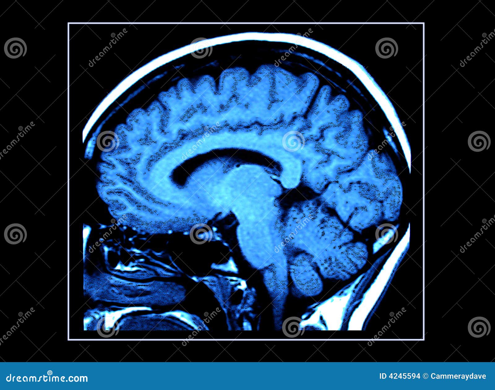 MRI Brain Scan stock photo. Image of hypothalamus, human - 4245594