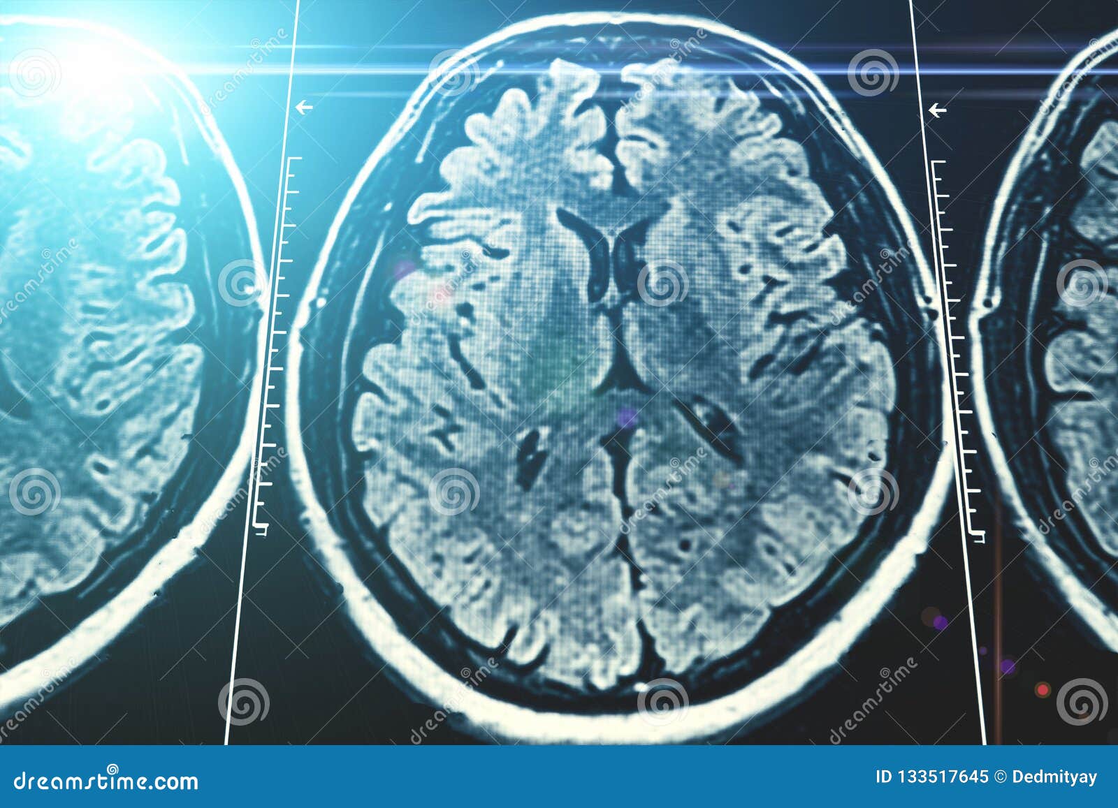 Mri Brain Scan Background, Magnetic Resonance Tomography, with Blue ...